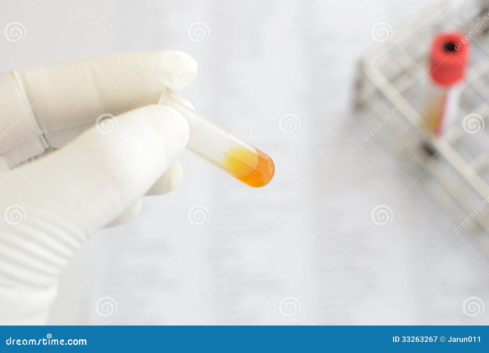 Siero itterico immagine stock. Immagine di siero, epatite - 33263267