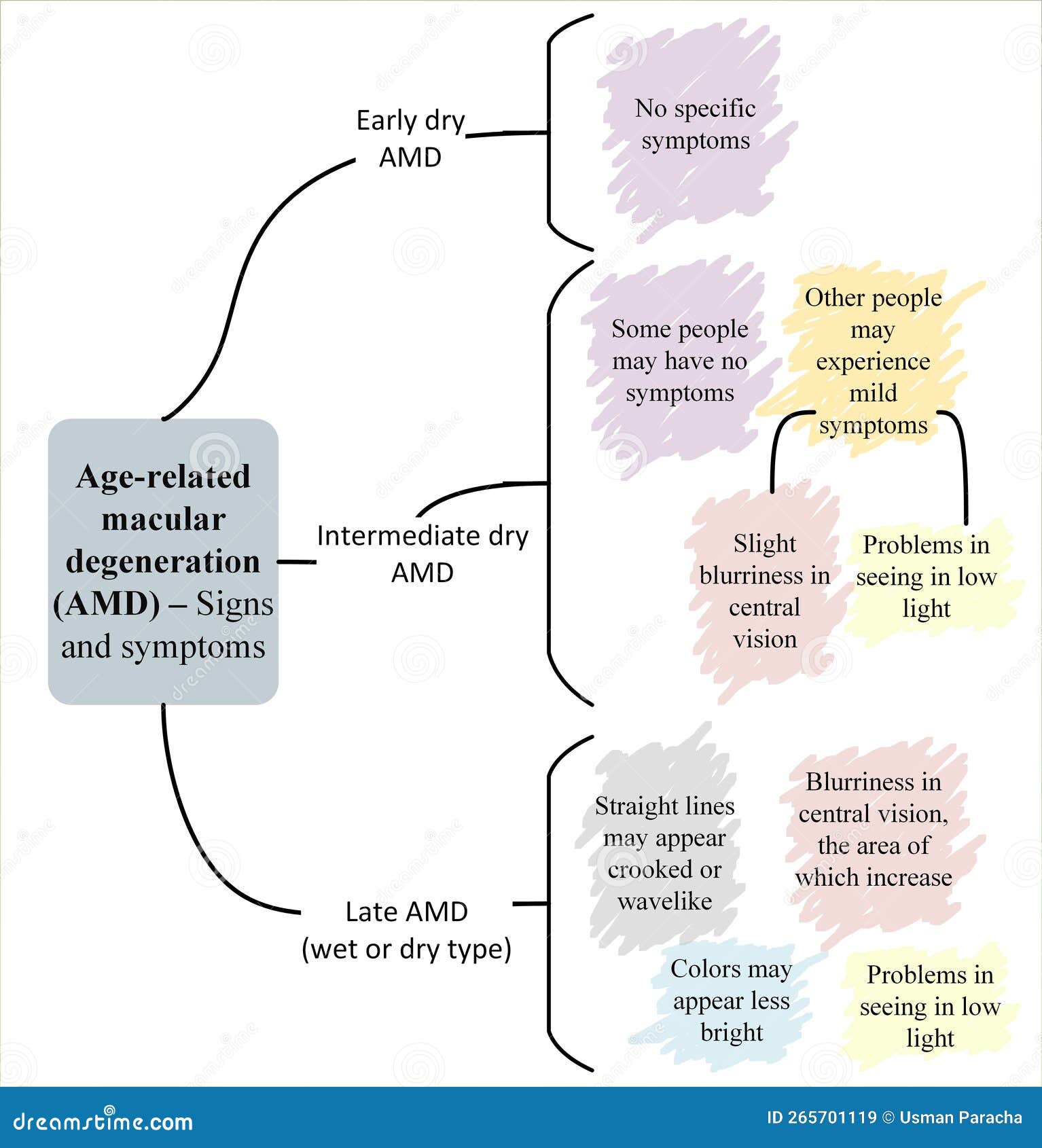 Signs and Symptoms of Age-related Macular Degeneration AMD Stock ...