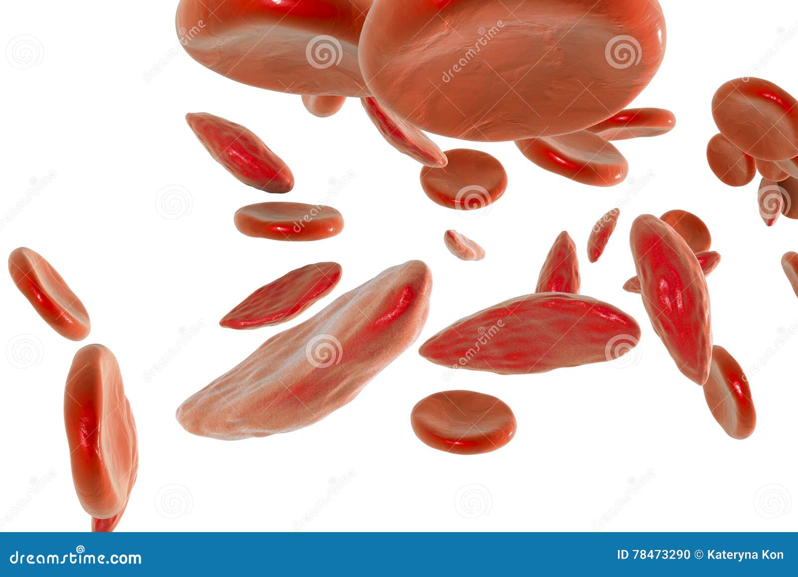 Sikkelcel En Normale Rode Bloedcellen Stock Illustratie - Illustration ...