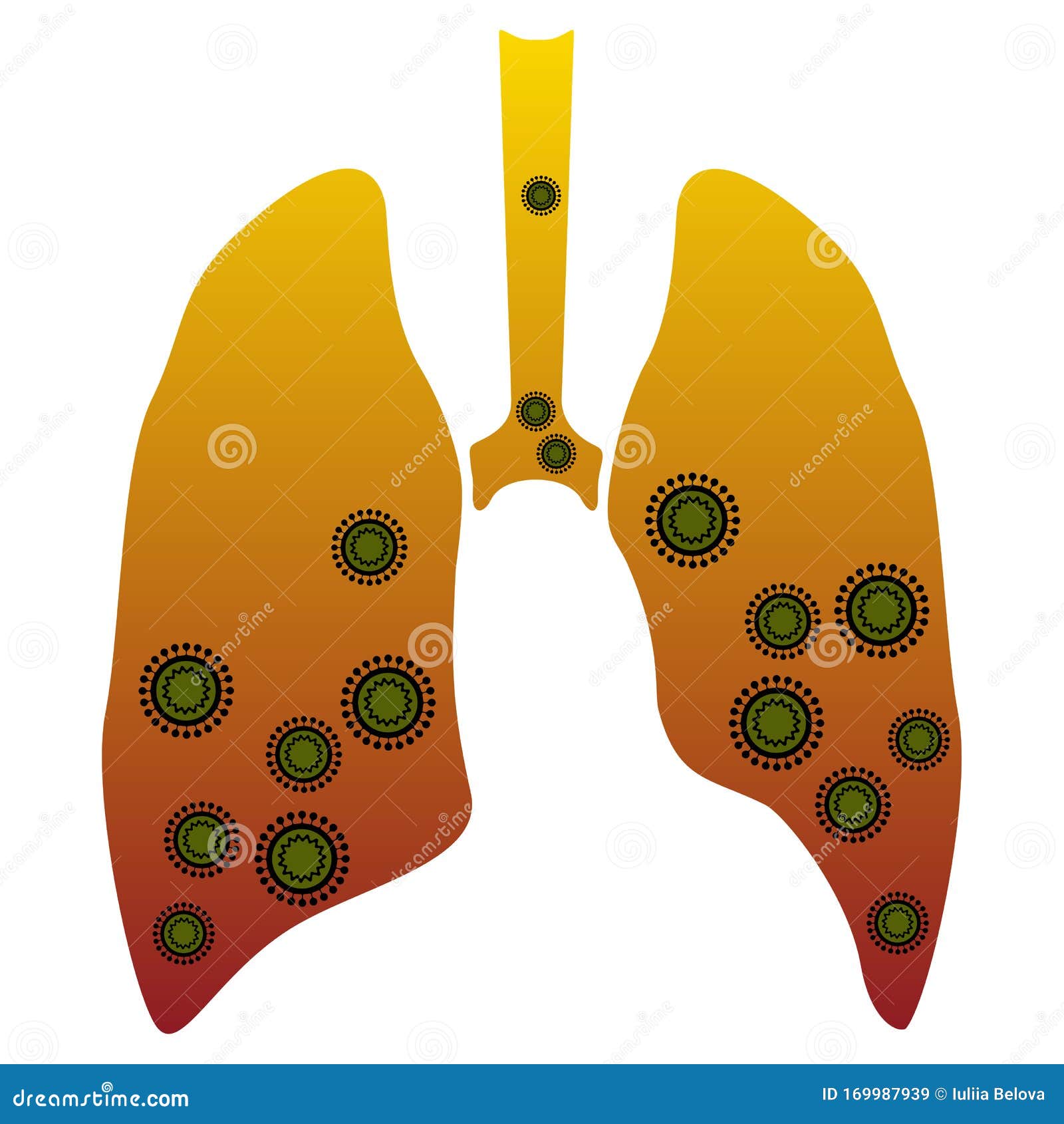 Pneumonia. Illustration Shows Normal And Infected Cartoon Vector ...