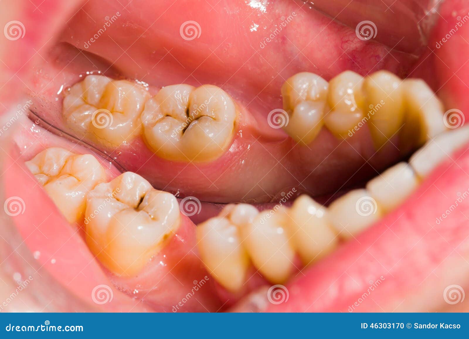Simple Cavity stock photo. Image of composite, healthy - 46303170