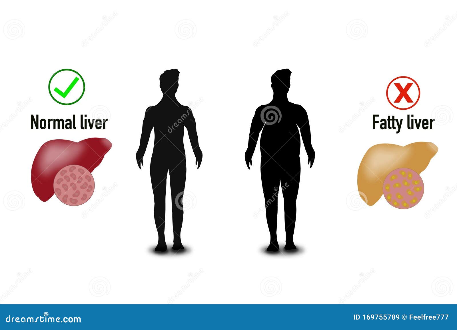 Normal Liver and Fatty Liver, Educational Sheet Stock Image - Image of ...