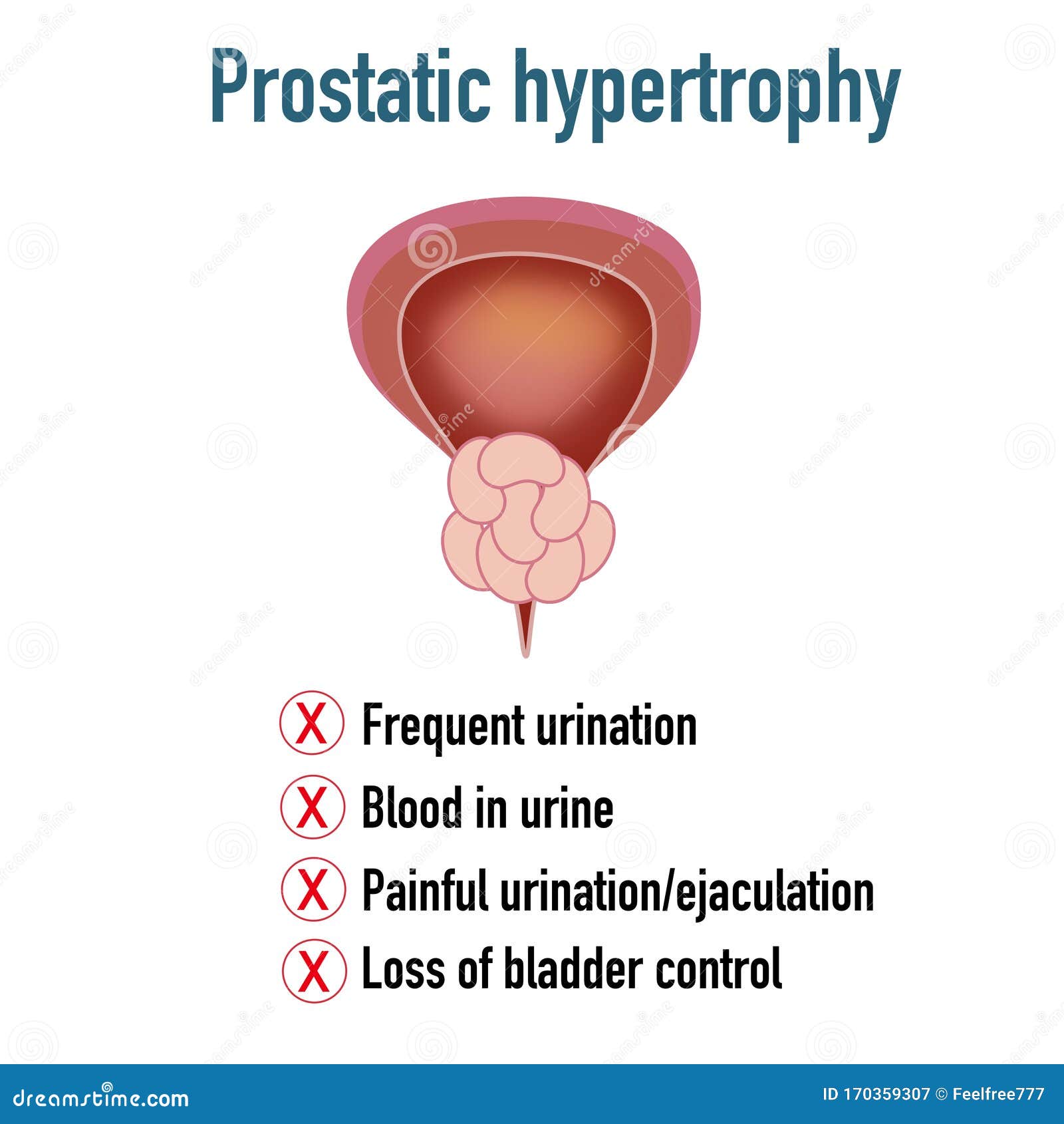Men Prostate Diseases, Hypertrophy Educational Sheet Royalty-Free Stock ...