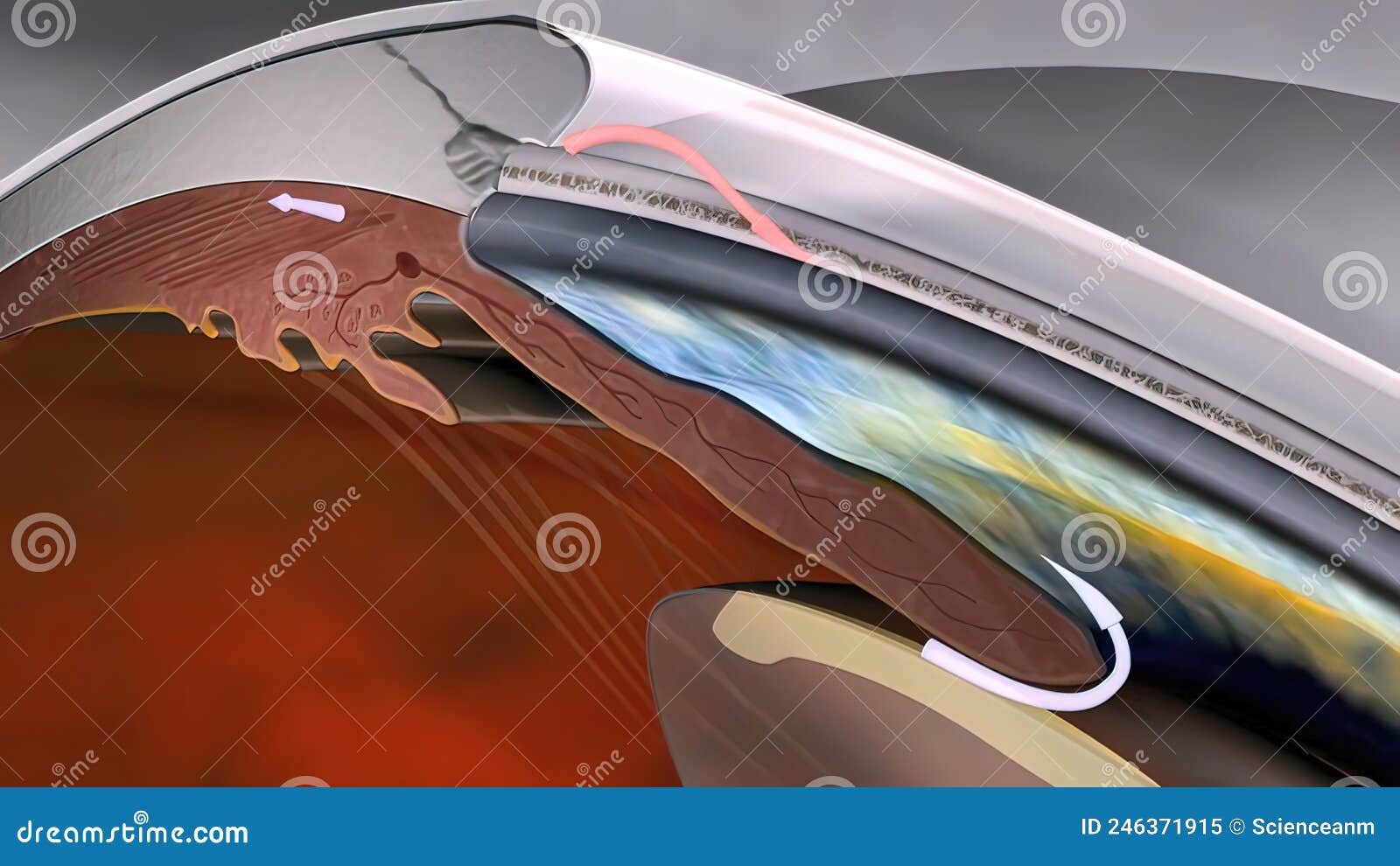 Glaucoma. Aqueous Humour Fluid Exits And Flow To Canal Of Schlemm Human ...