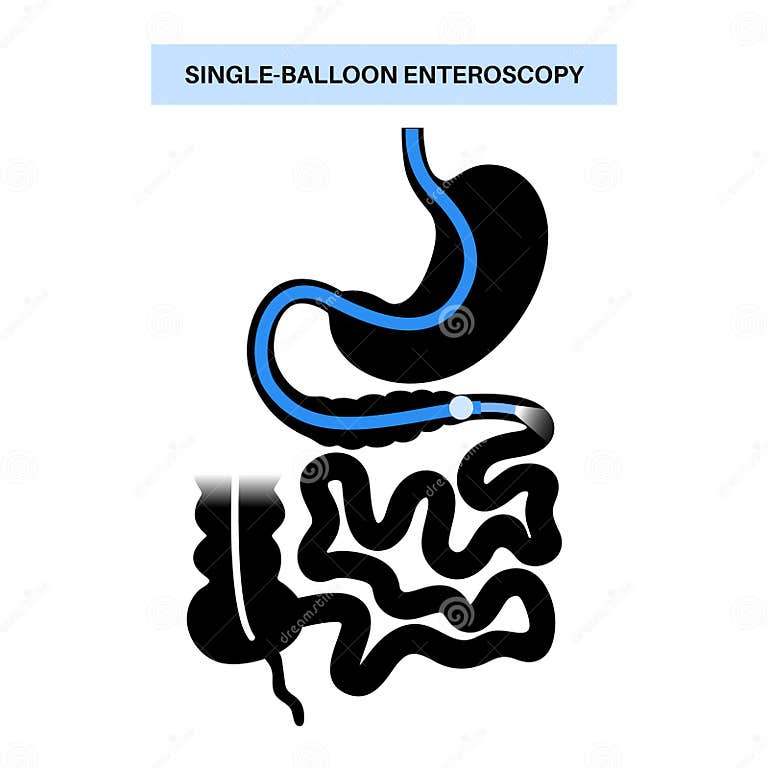 Single balloon enteroscopy stock illustration. Illustration of mucosa ...