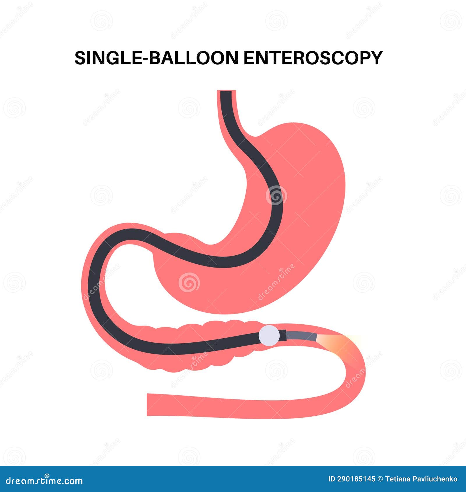Single balloon enteroscopy stock illustration. Illustration of vector ...