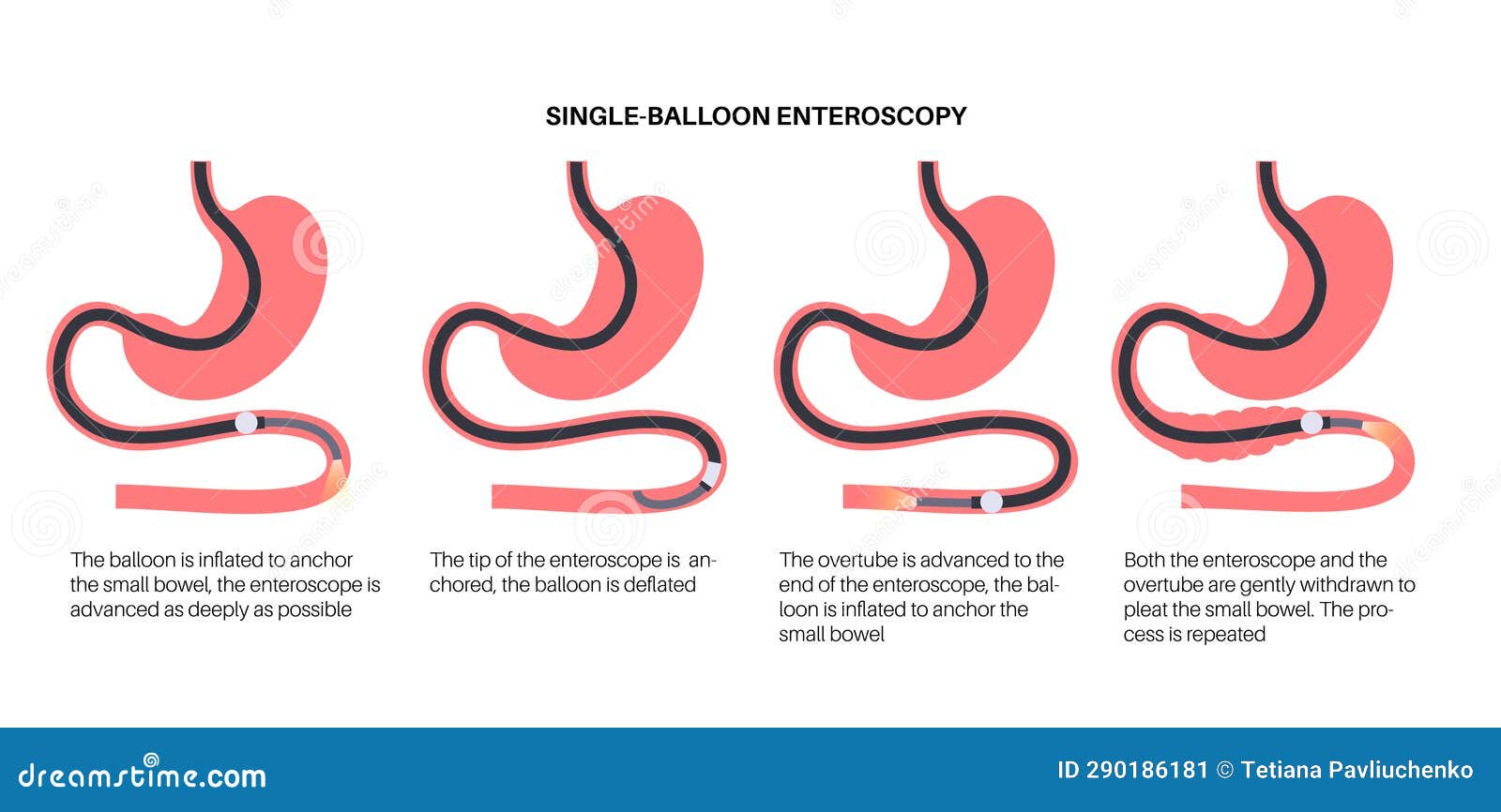 Single balloon enteroscopy stock illustration. Illustration of ...