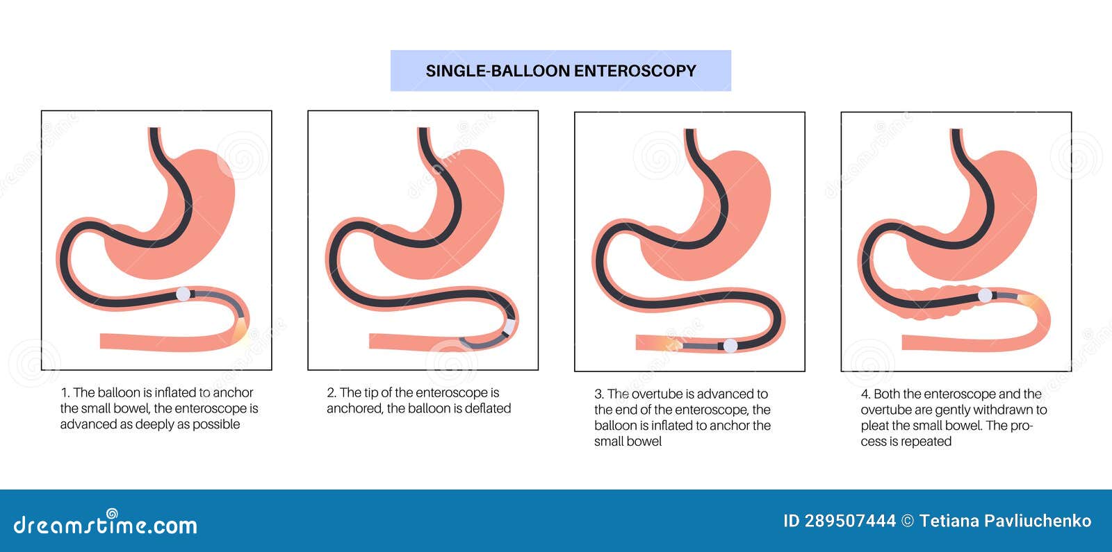 Single balloon enteroscopy stock illustration. Illustration of ...