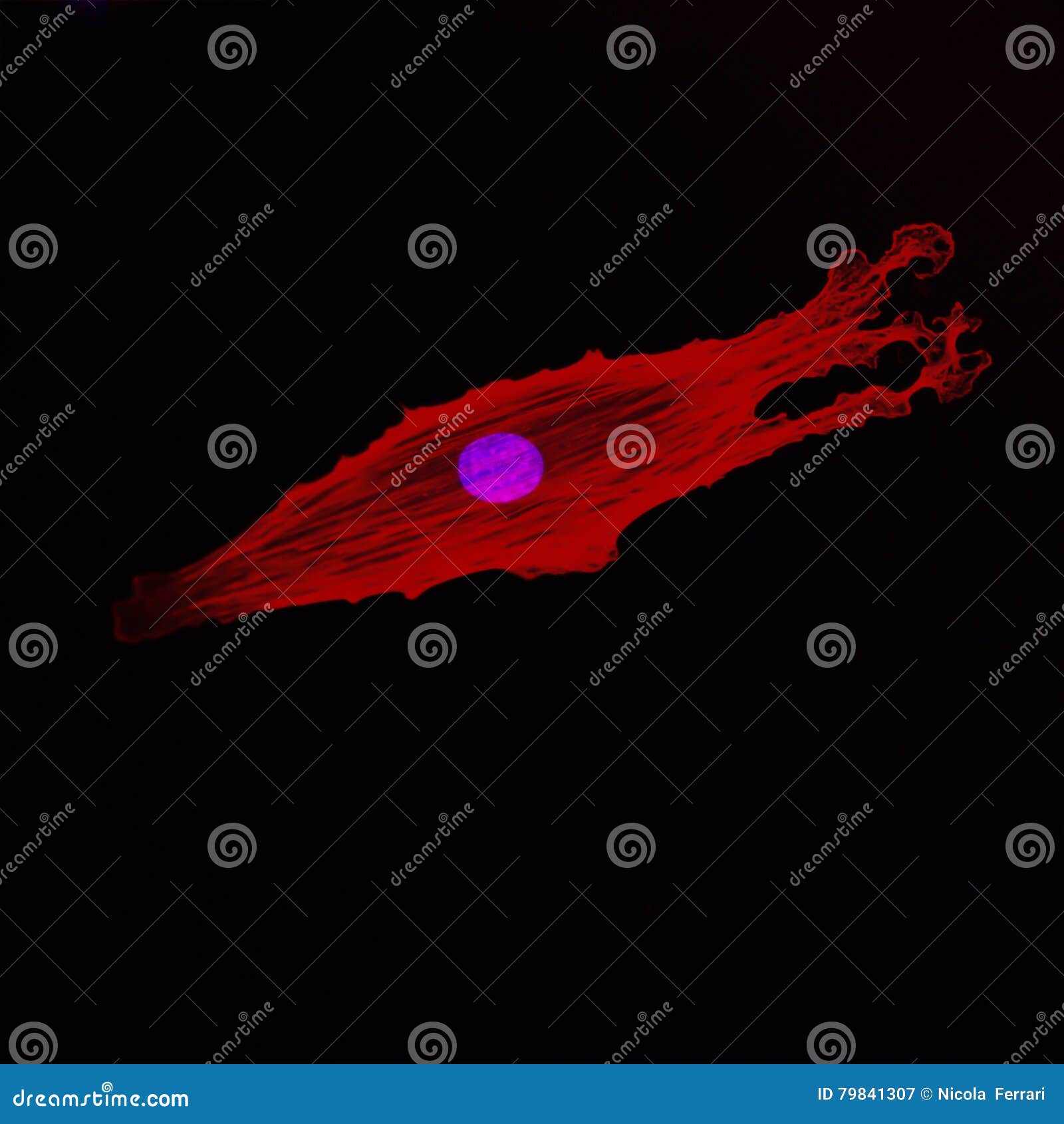 Single Cancer Cell Invading during the Metastatic Process. Visible ...