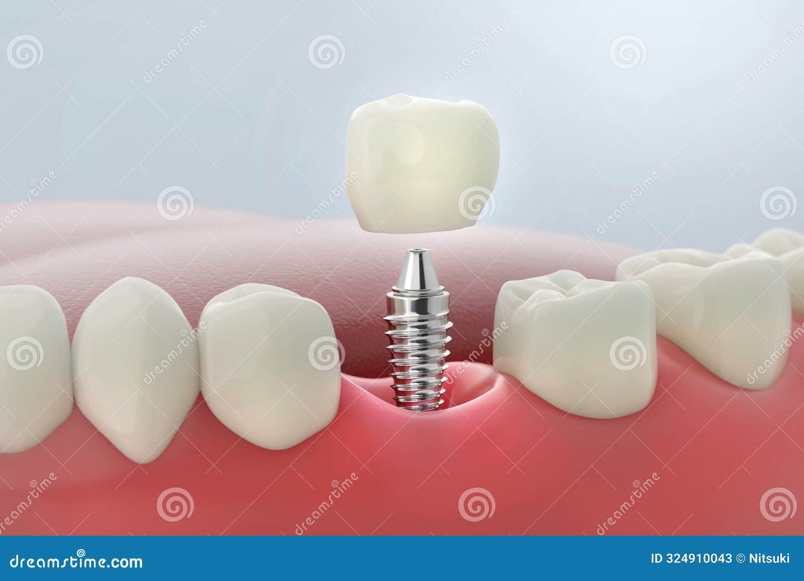 Single Dental Implant at Molar Teeth Stock Illustration - Illustration ...