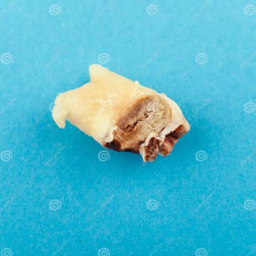 Single Highly Decayed Wisdom Tooth on a Blue Background Stock Photo ...