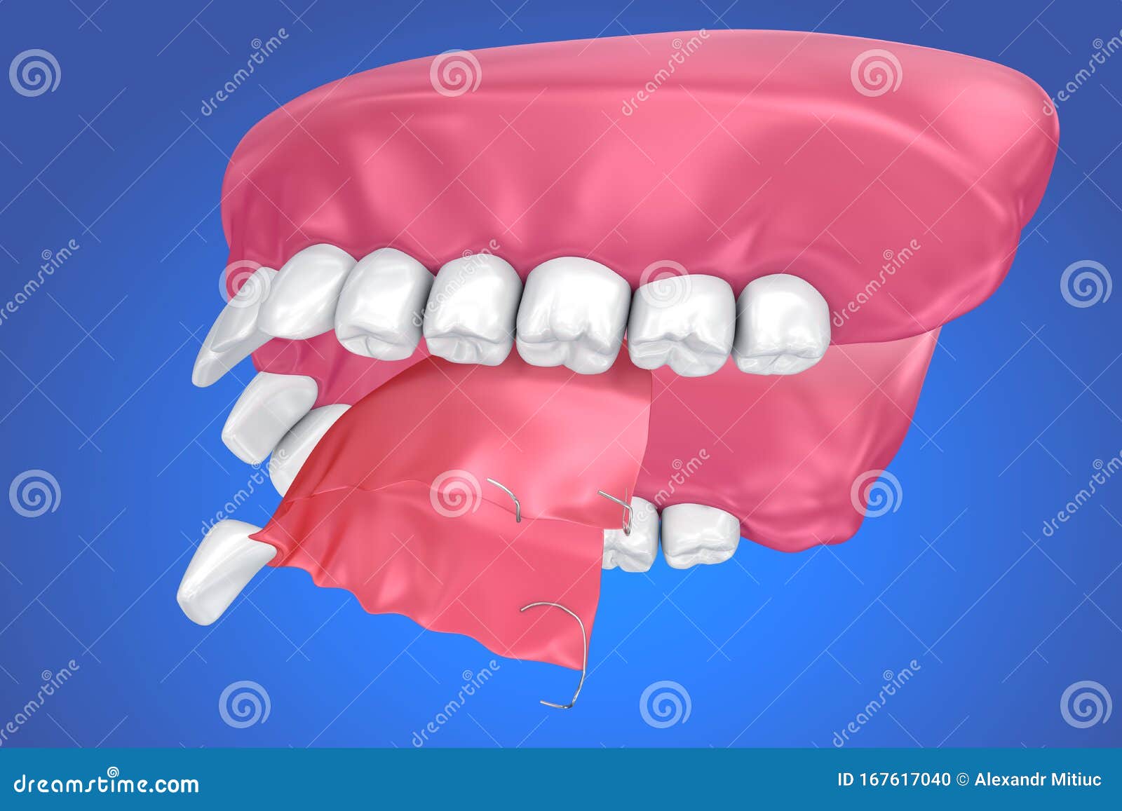 Single Missing Tooth - Removable Partial Denture . Illustration Stock ...