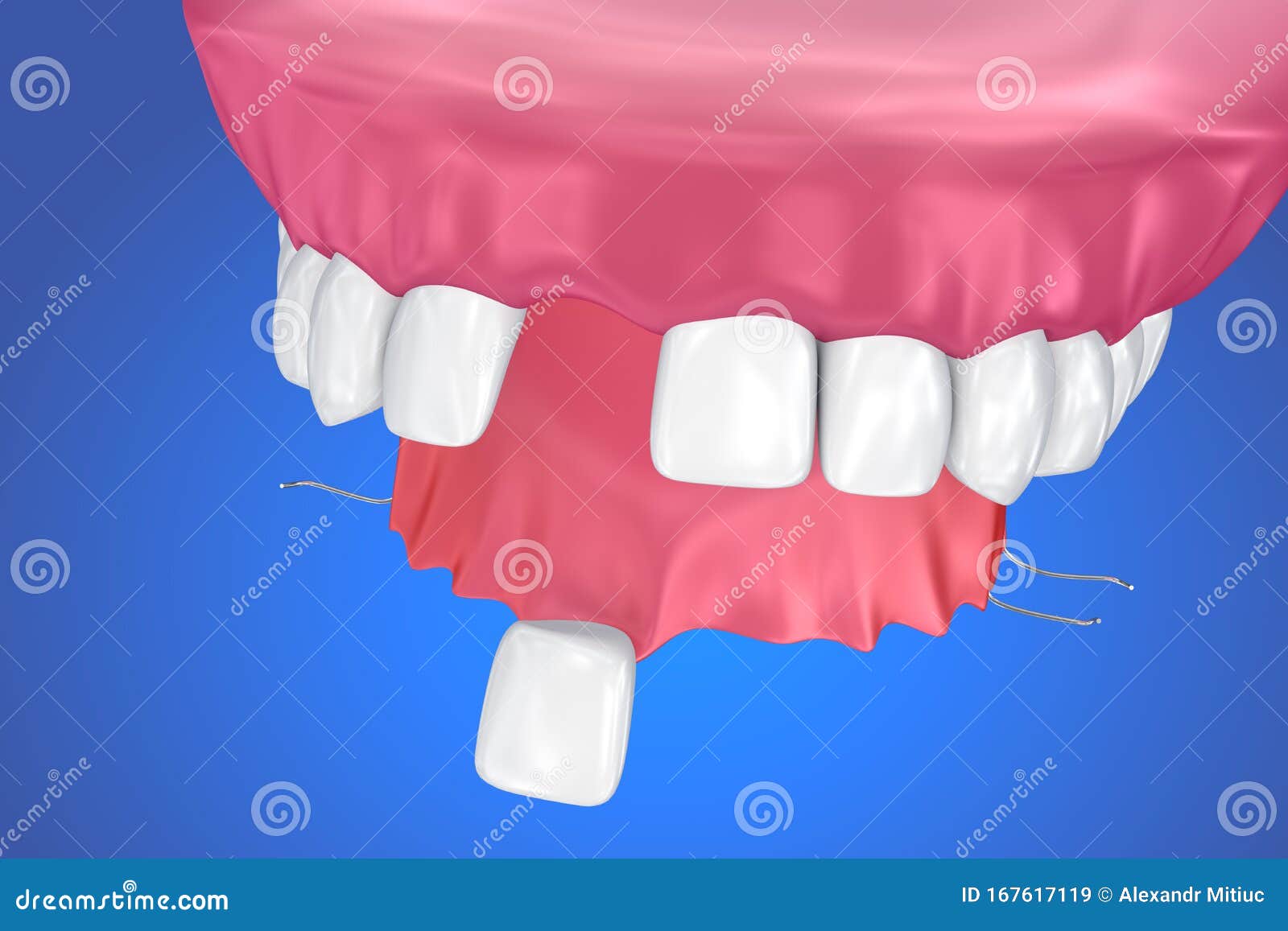 Removable Partial Denture. Medically Accurate Royalty-Free Cartoon ...