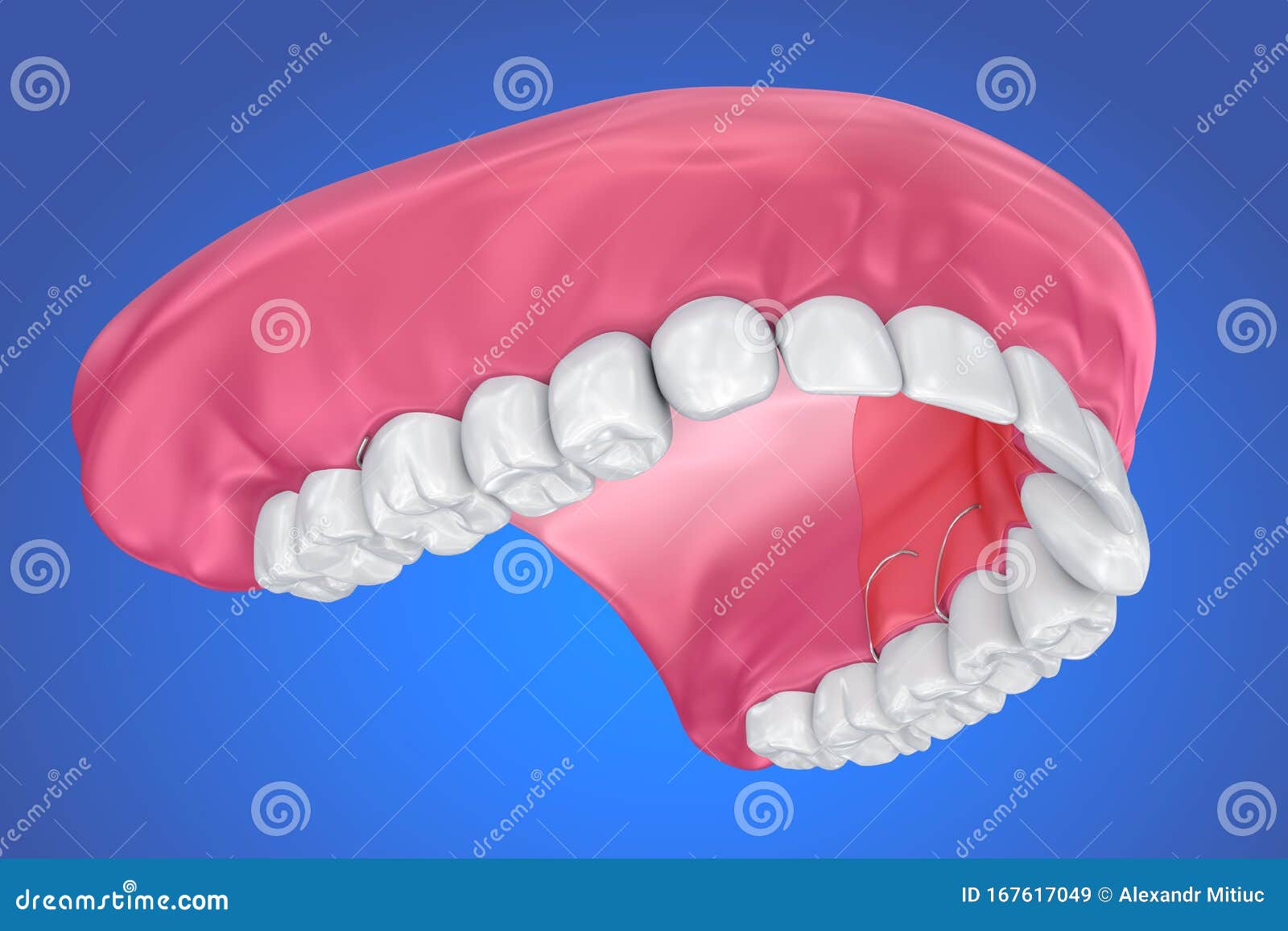Single Missing Tooth - Removable Partial Denture . Illustration Royalty ...