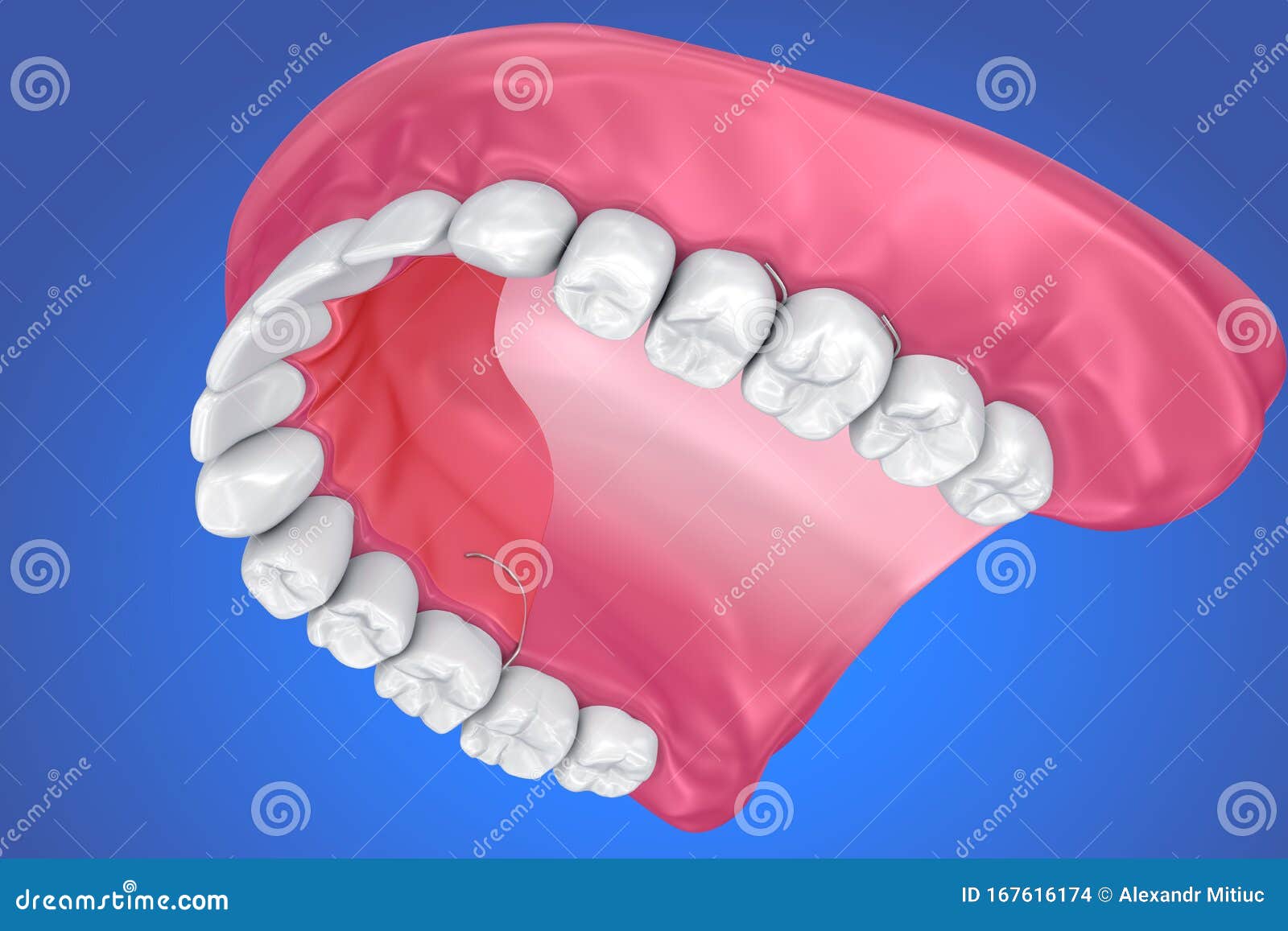 Single Missing Tooth - Removable Partial Denture Stock Illustration ...