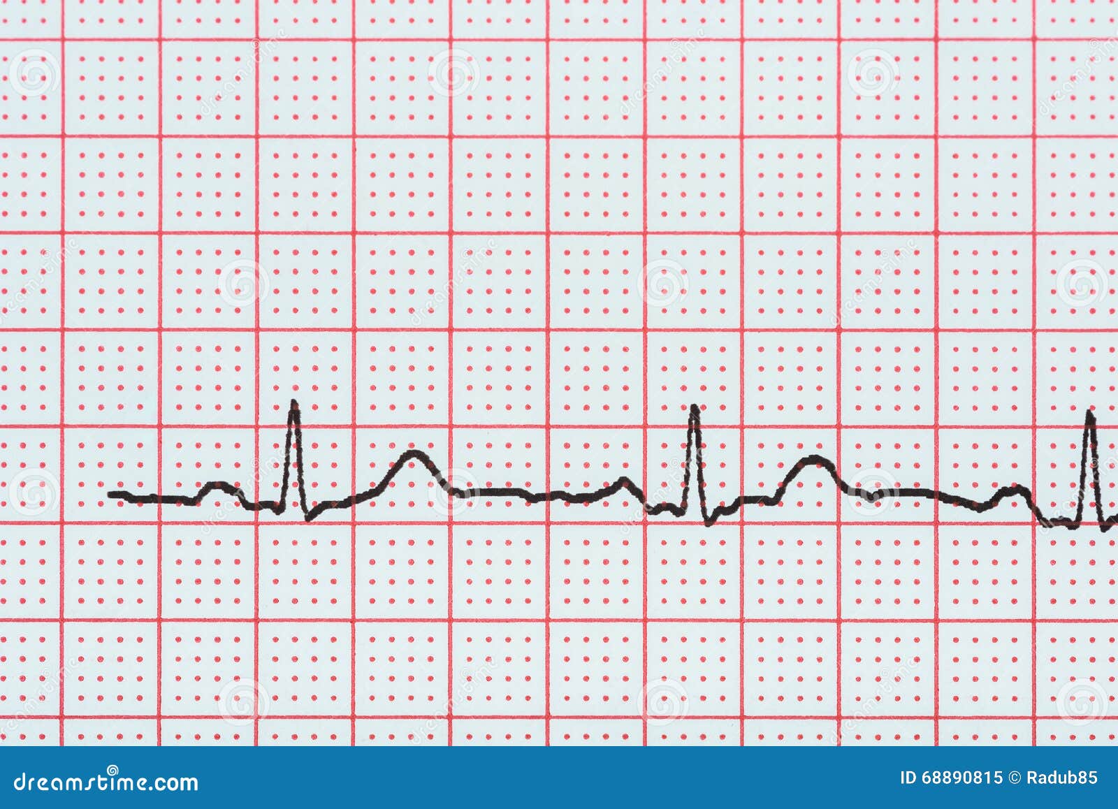 Sinus Heart Rhythm on Electrocardiogram Record Paper Showing Normal ... Sinus Heart Rhythm on Electrocardiogram Record Paper Showing Normal ...