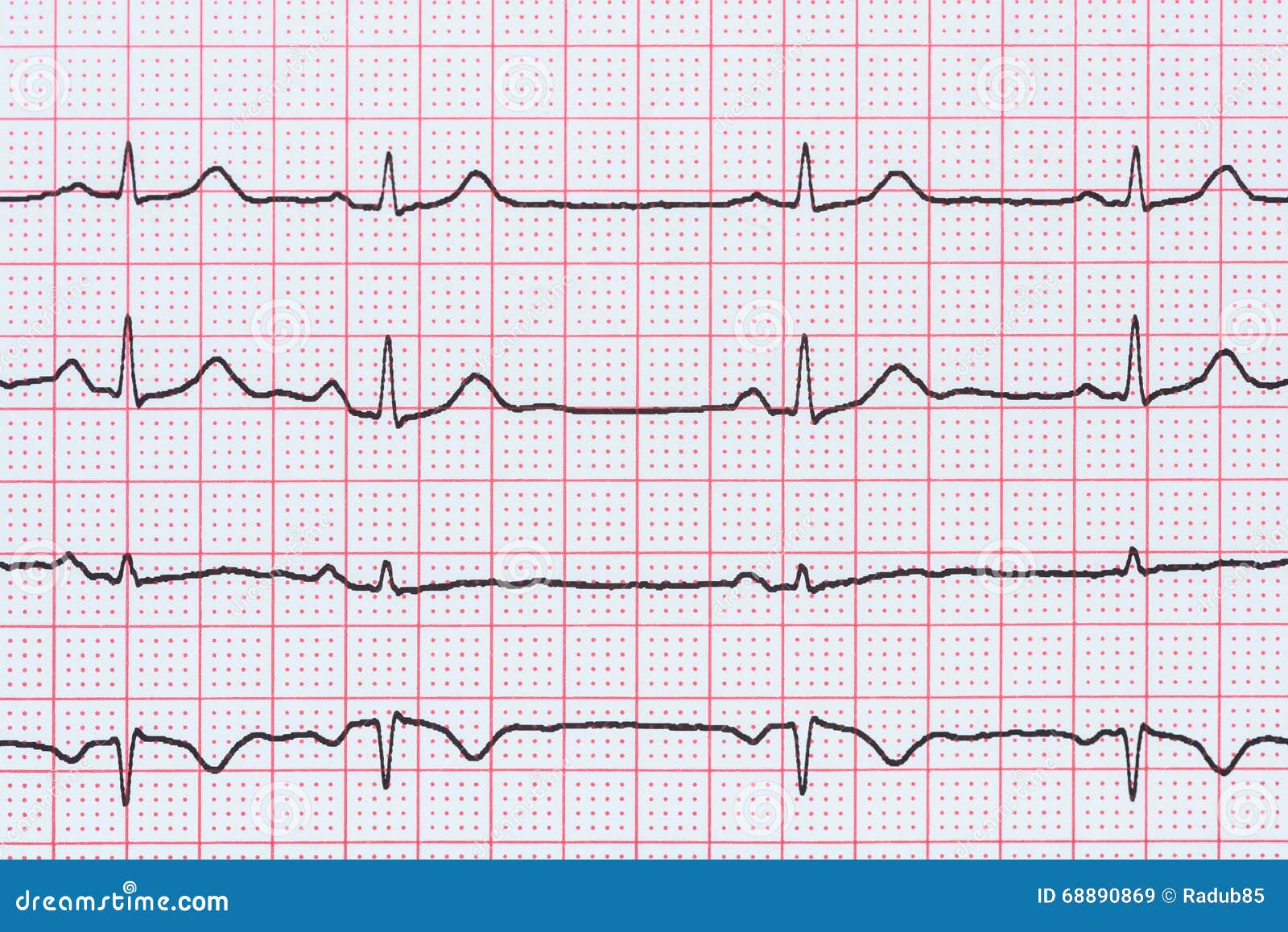 Sinus Heart Rhythm on Electrocardiogram Record Paper Showing Normal ... Sinus Heart Rhythm on Electrocardiogram Record Paper Showing Normal ...
