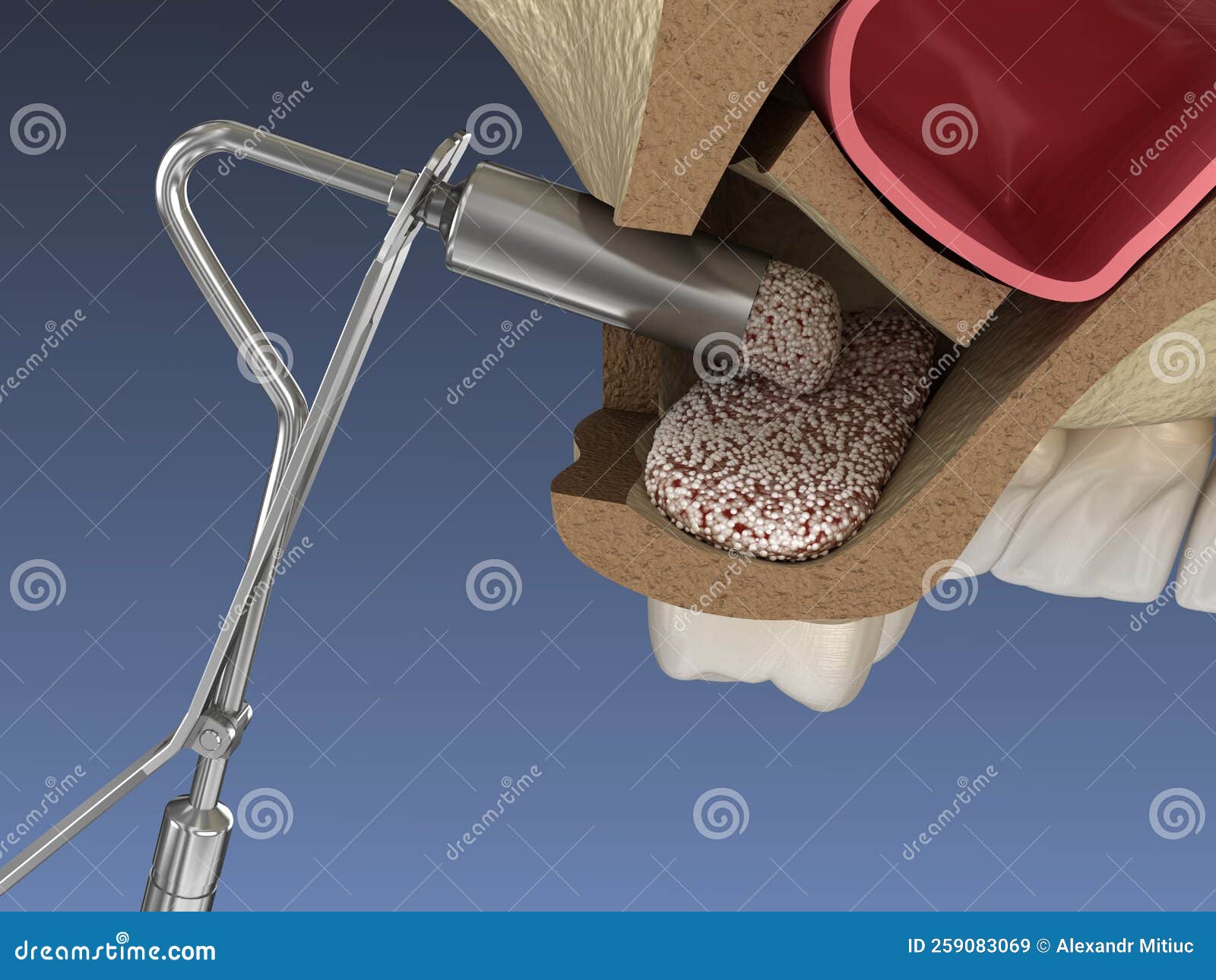 Sinus Lift Surgery - Sinus Augmentation. Illustration Royalty-Free ...