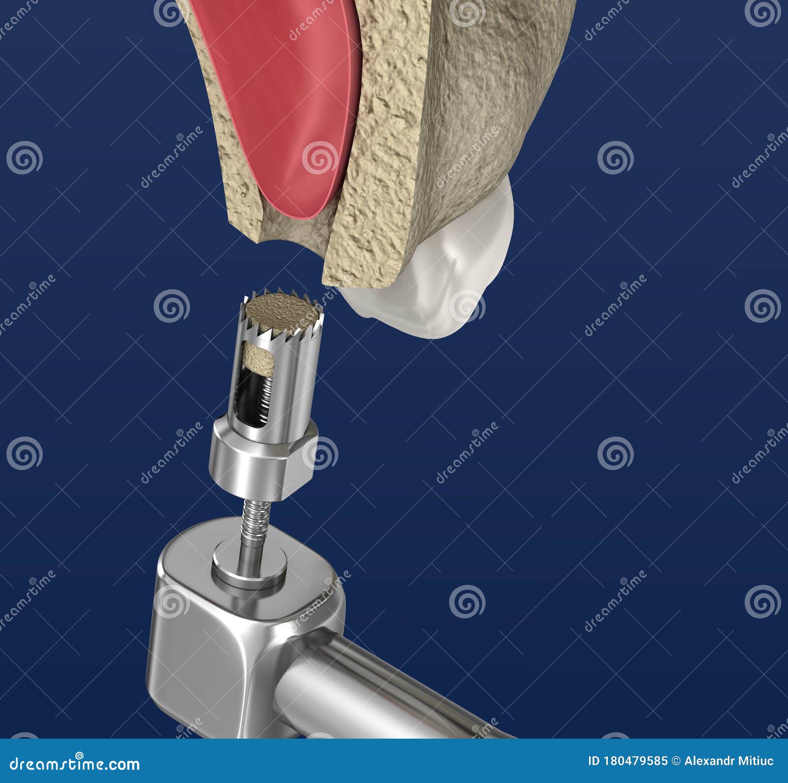 Sinus Lift Surgery - Sinus Augmentation. Illustration Stock ...