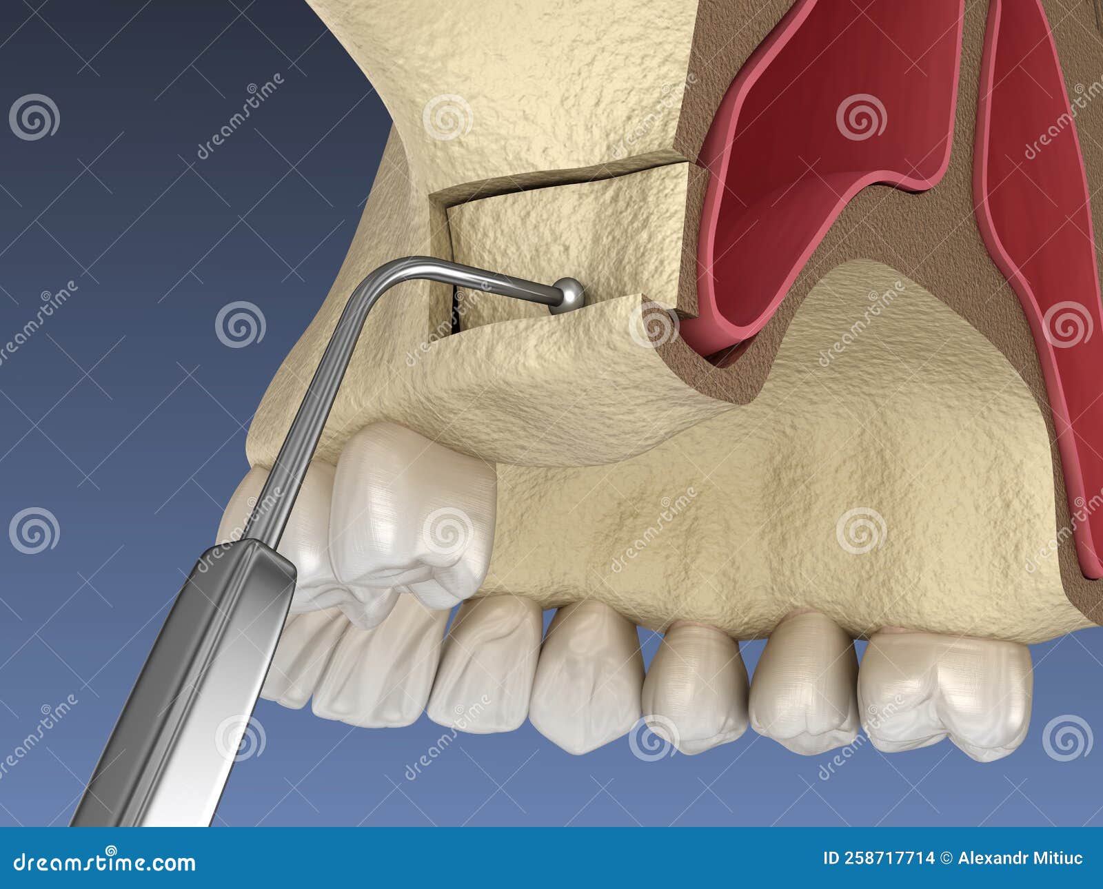 Sinus Lift Surgery - Creating Side Access To the Sinus. 3D Illustration ...