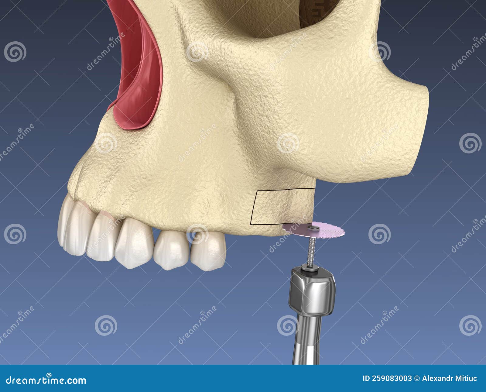 Sinus Lift Surgery - Creating Side Access To the Sinus. 3D Illustration ...