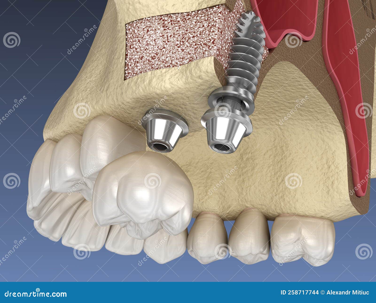 Sinus Lift Surgery - Implant Installation. 3D Illustration Stock ...