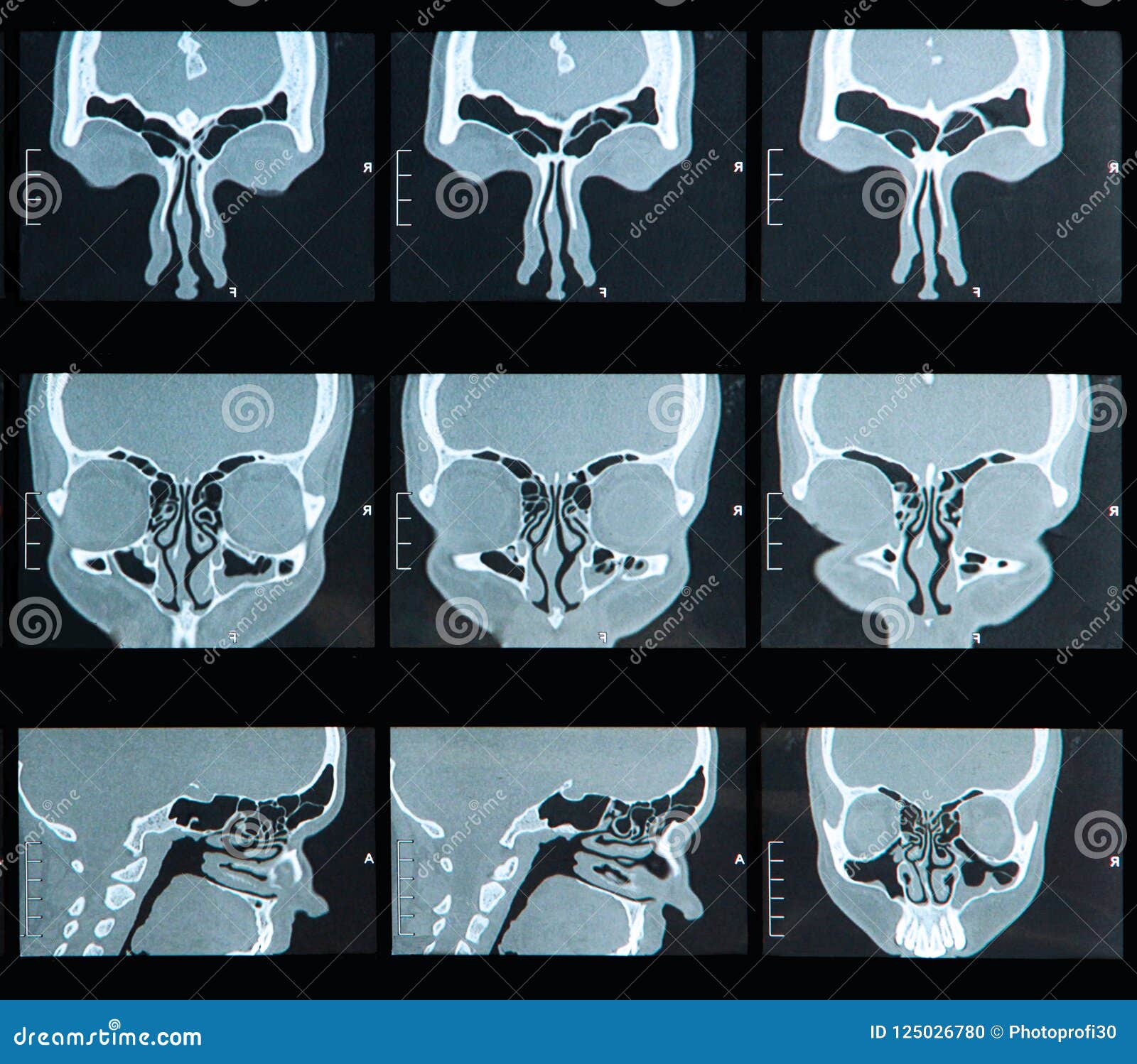 Sinus MRI stock photo. Image of chronic, asthma, frontal - 125026780