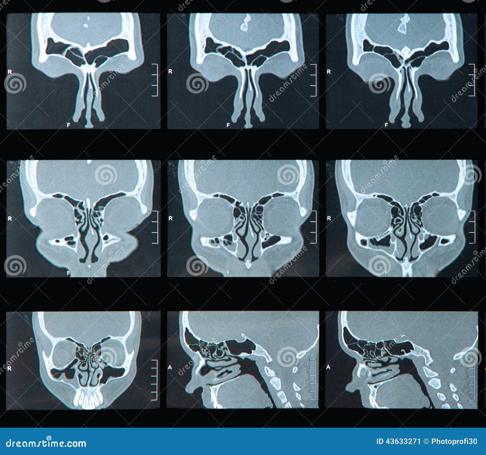 CT Scan Of The Ethmoid Sinus Air Cells Stock Photography ...