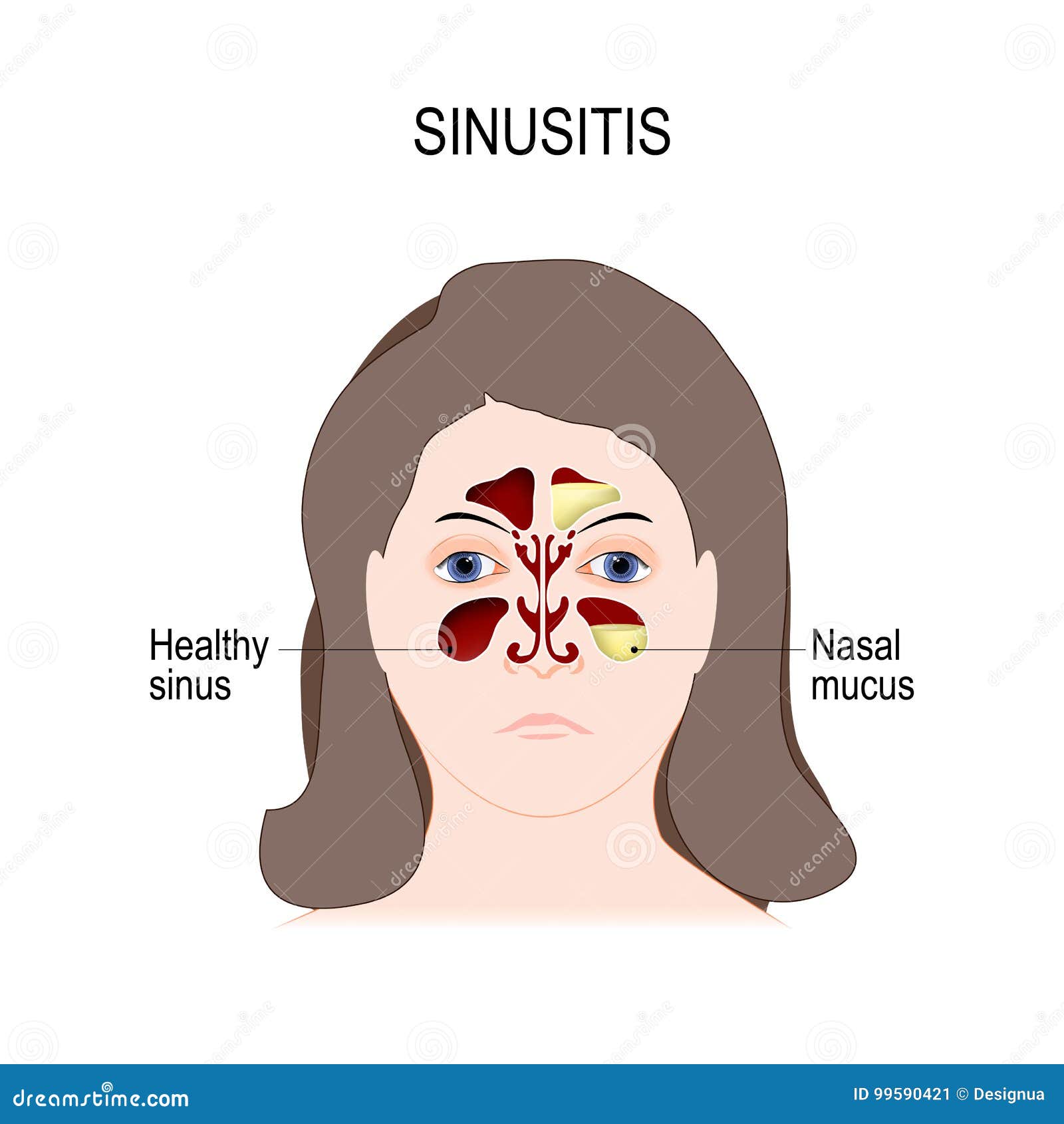 Sinusitis Infección Del Sino Ilustración del Vector - Ilustración de ...