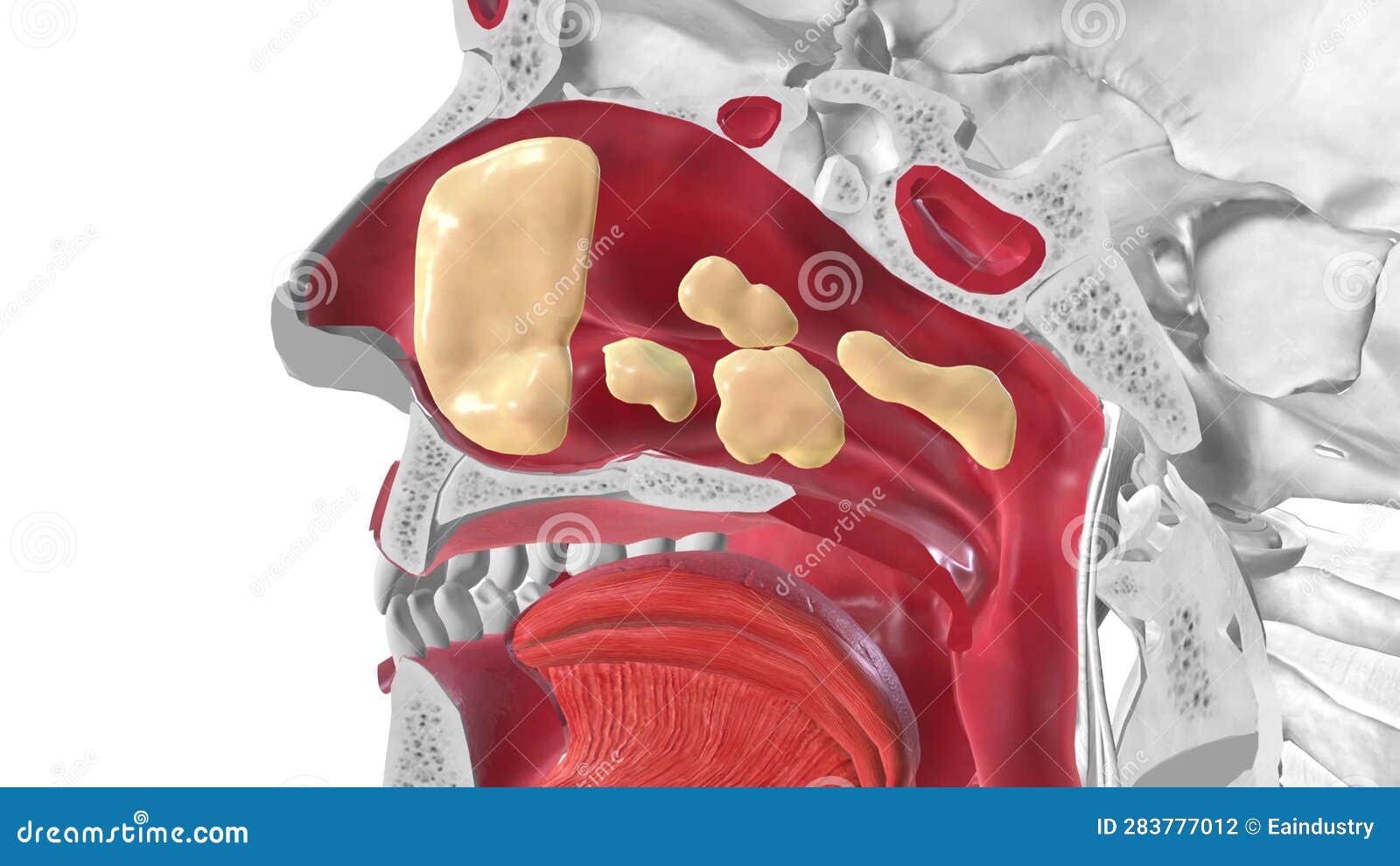 Sinusitis is an Inflammation, or Swelling, of the Tissue Lining Your ...