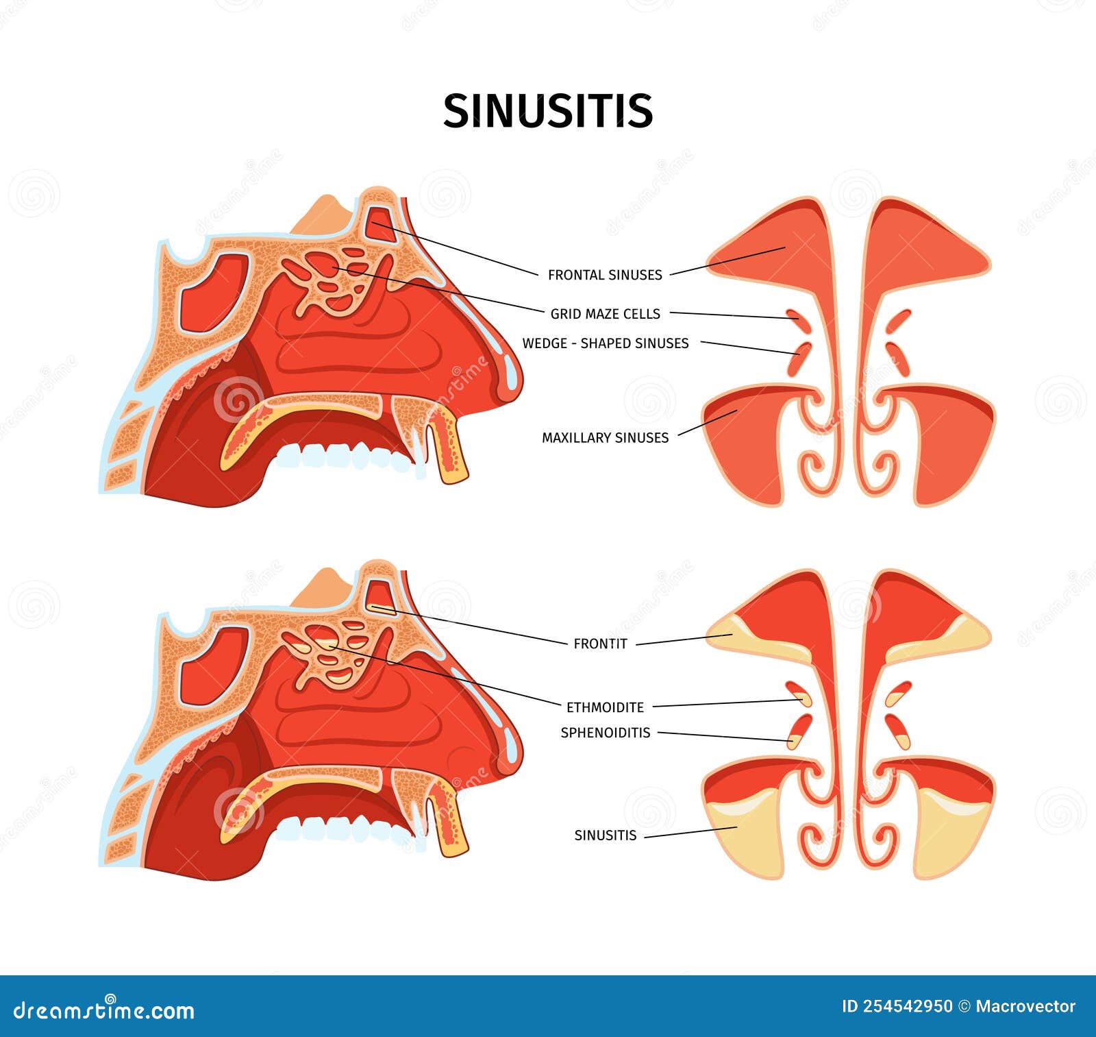 Sinusitis Infographics Illustration Иллюстрация штока - иллюстрации ...