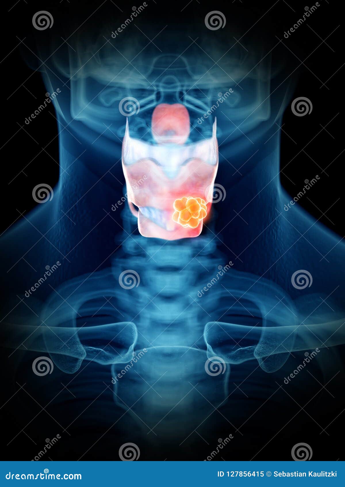 Sirve El Tumor De La Laringe Stock de ilustración - Ilustración de ...