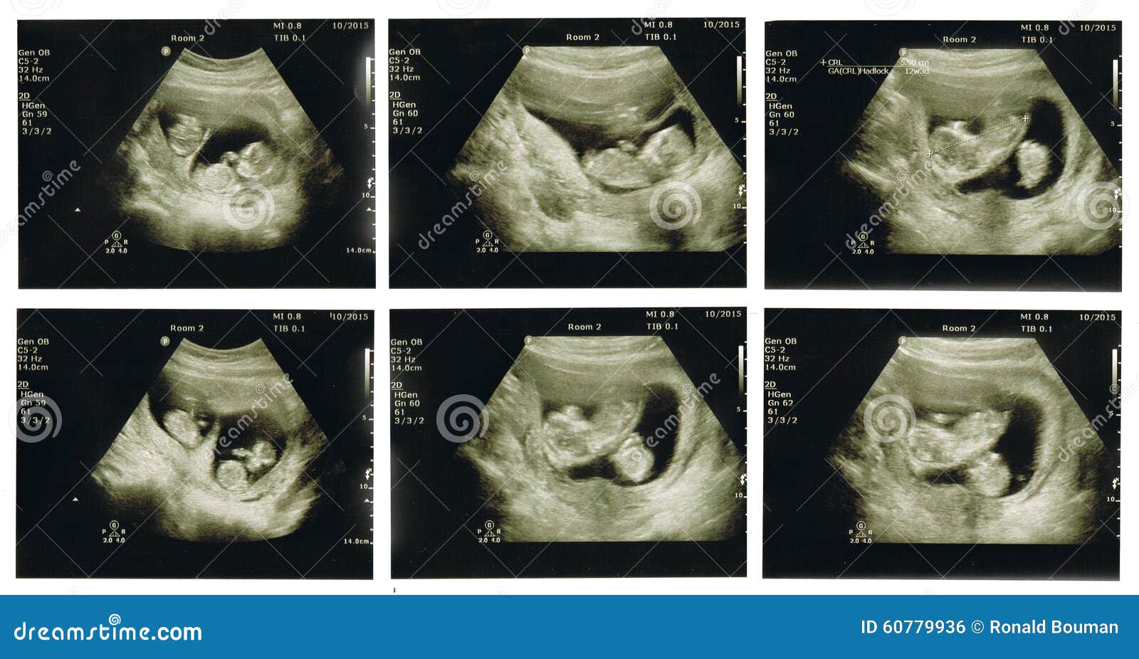 Twins Ultrasound 30 Weeks