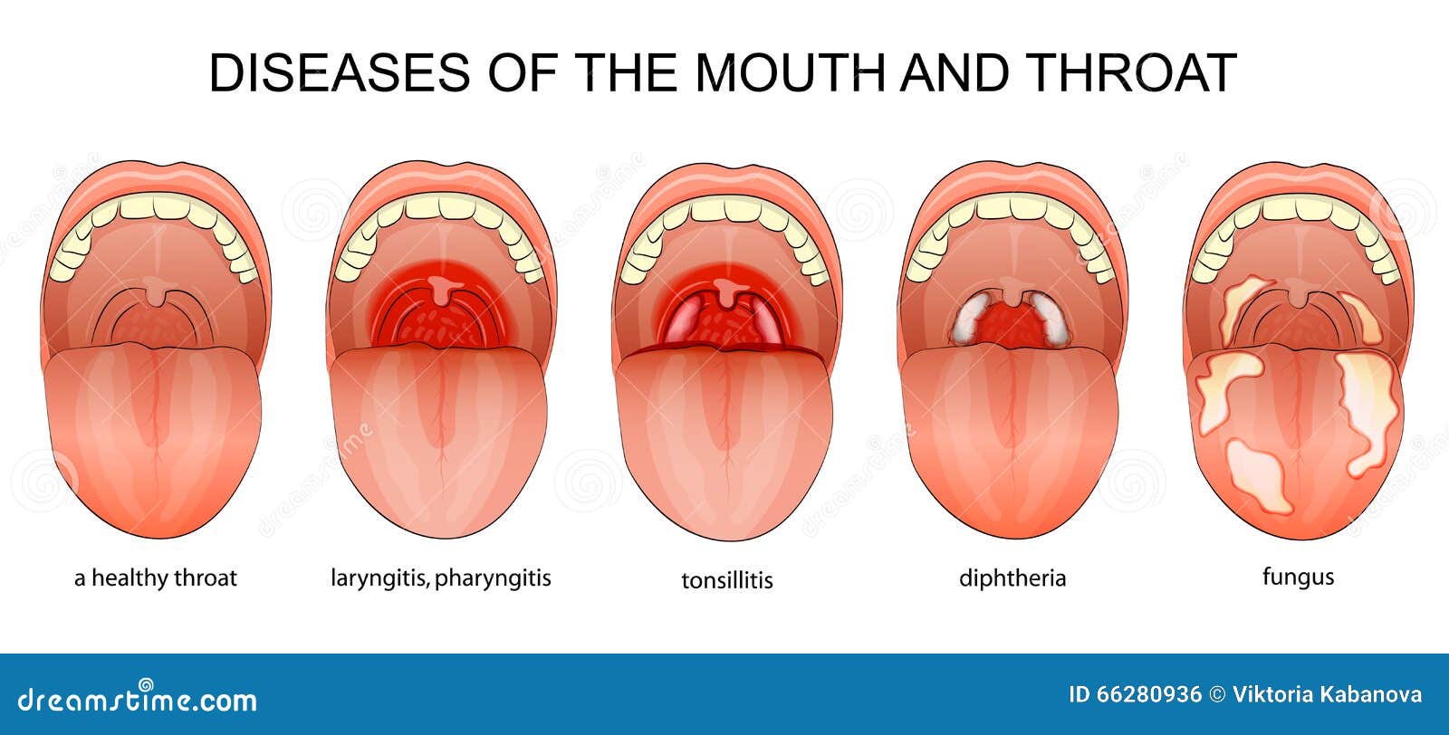 SJUKDOMAR AV HALSEN vektor illustrationer. Illustration av faryngit ...