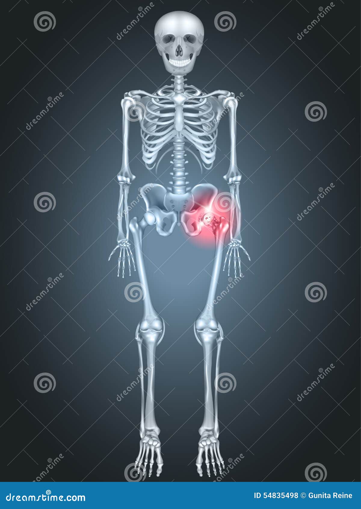 Skelet met Heuppijn vector illustratie. Illustration of inplanting ...