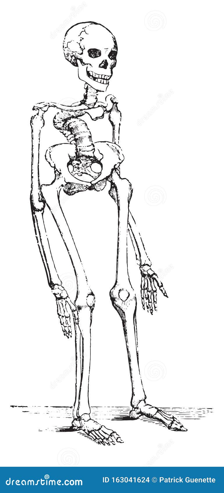 Skeleton Deformed by Rickets Which Deflected the Spinal Column, Vintage ...