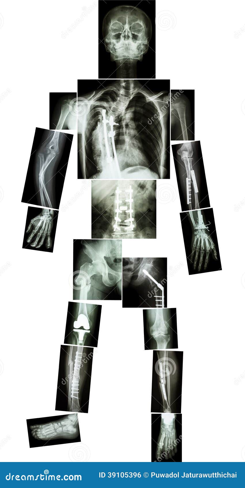 Multiple Fracture At Index,little Finger,metacarpal Bone Royalty-Free ...
