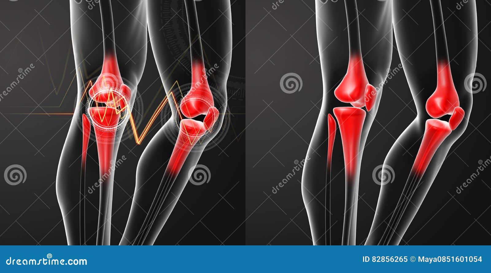 Skeleton leg stock illustration. Illustration of osteoarthritis - 82856265