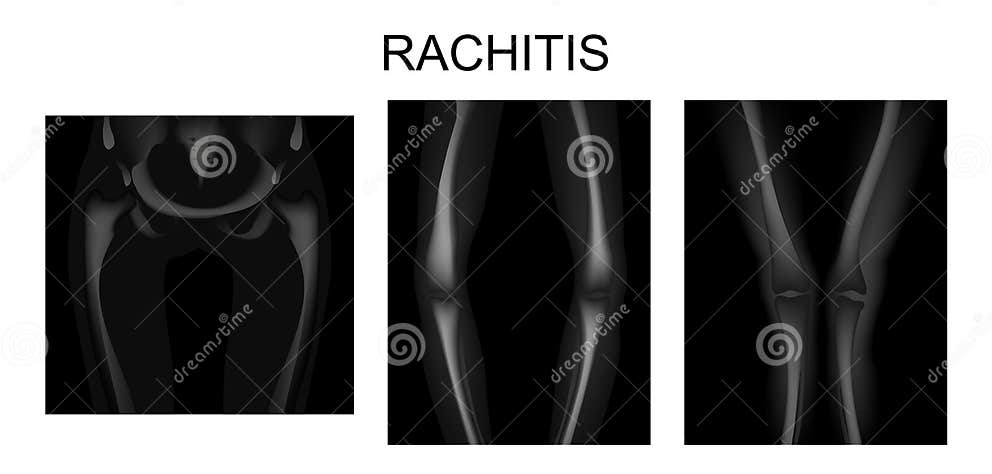 The Skeleton of the Lower Limbs in Rickets Stock Vector - Illustration ...