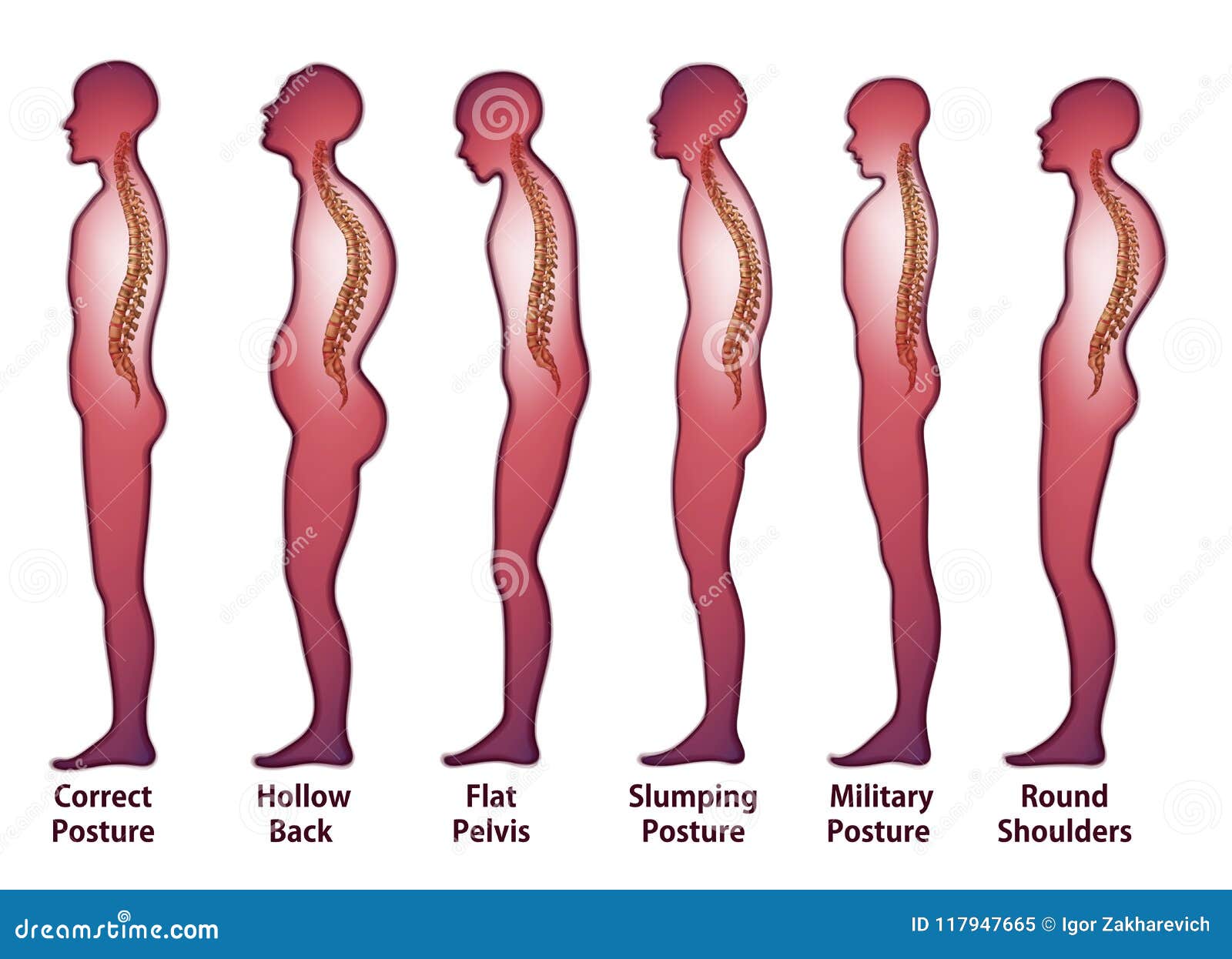 Skeleton_Spine Posture stock illustration. Illustration of incorrect ...