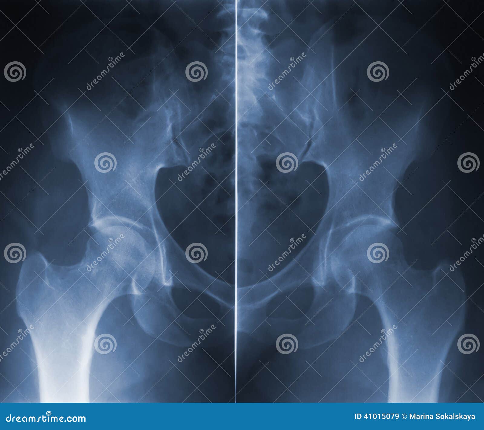 Skiagram hip backbone stock image. Image of anatomical - 41015079