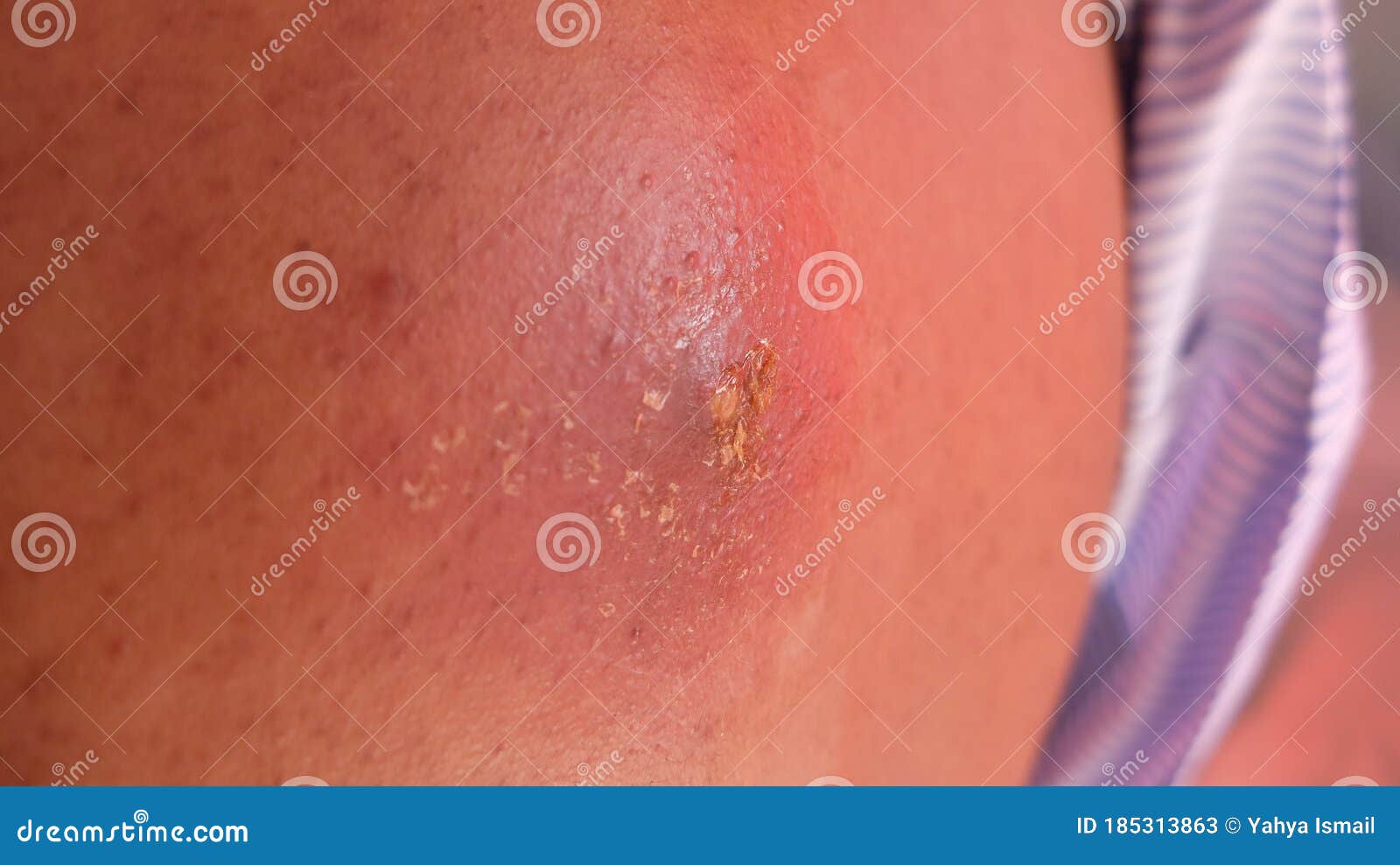 Skin Abscess Requite Incisiin And Drainage Royalty-Free Stock ...