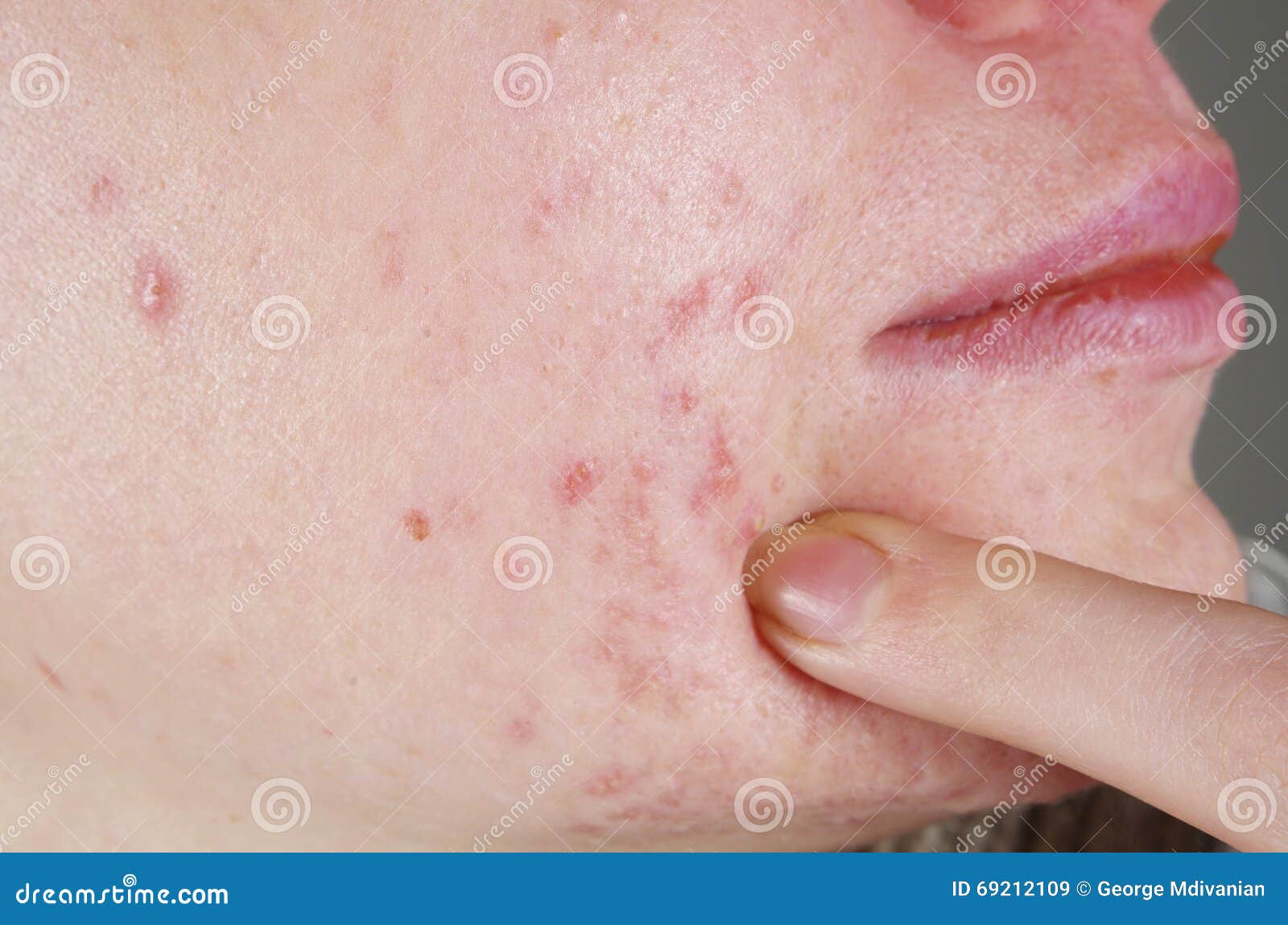 Skin with acne problems stock image. Image of female - 69212109