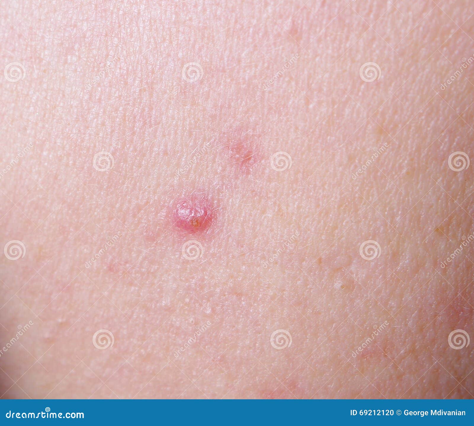 Skin with acne problems stock photo. Image of cosmetology - 69212120