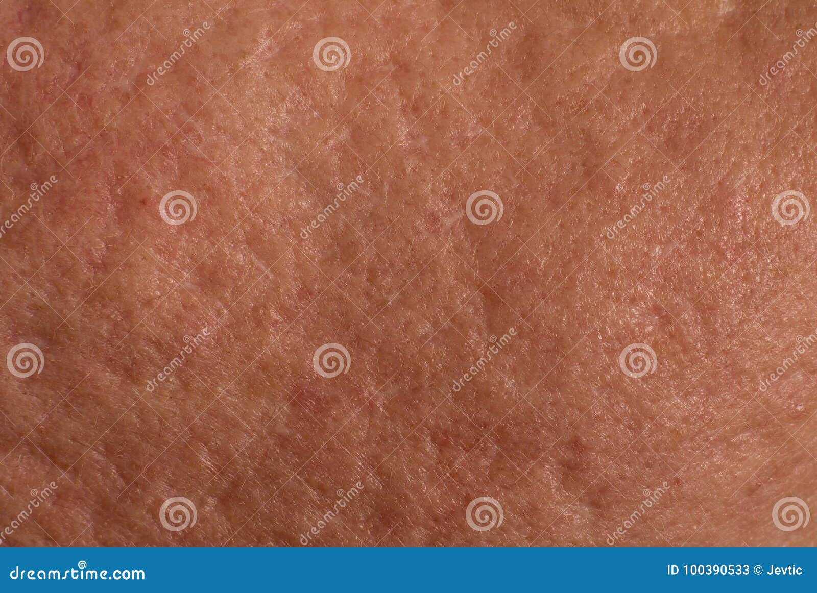 Skin with acne scars stock image. Image of cosmetic - 100390533