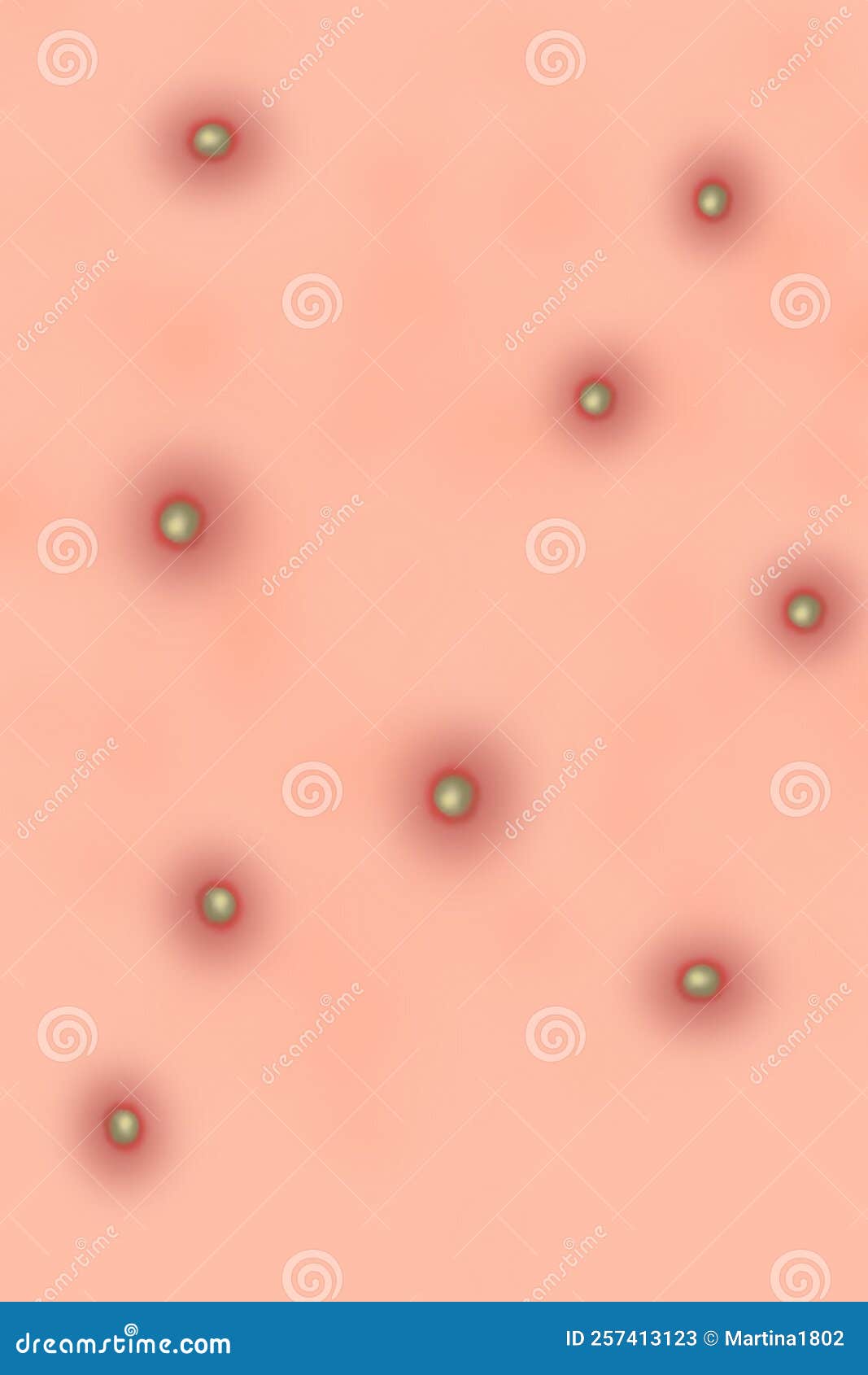 The Skin Affected By Ringworm Pink. Pityriasis Rosea. Vector ...