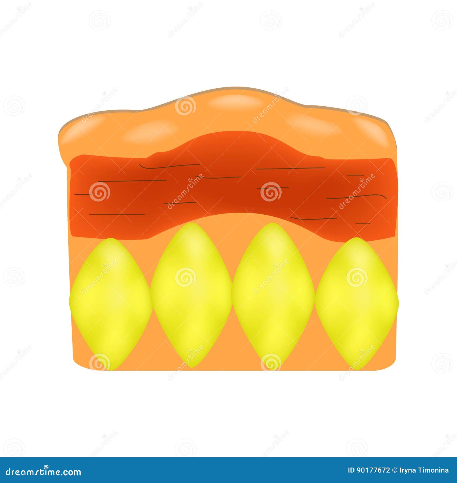 Cellulitis Skin Illustration | CartoonDealer.com #391775767