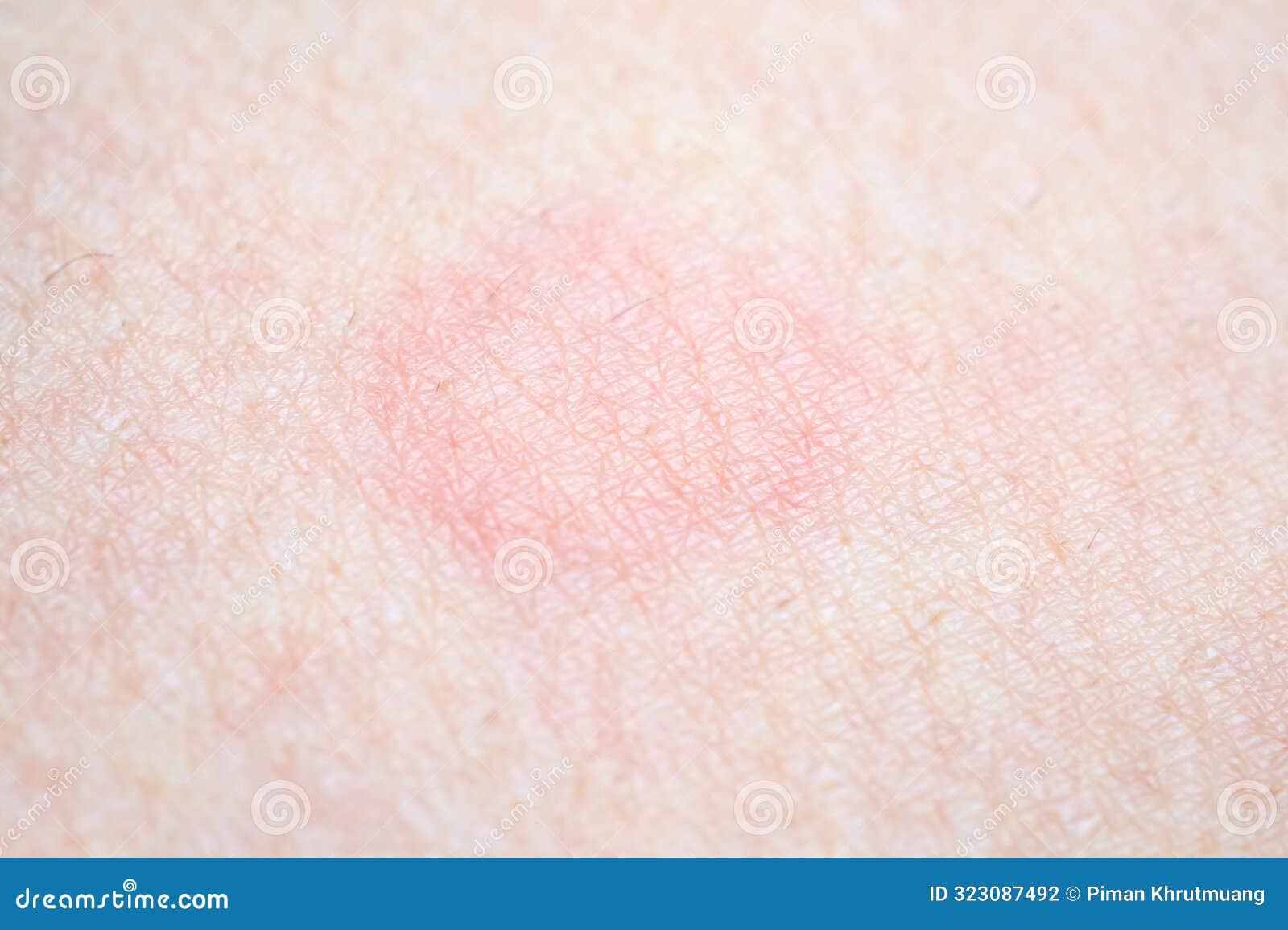 Skin Allergy Rash Dermatitis Texture Closeup Stock Photo - Image of ...