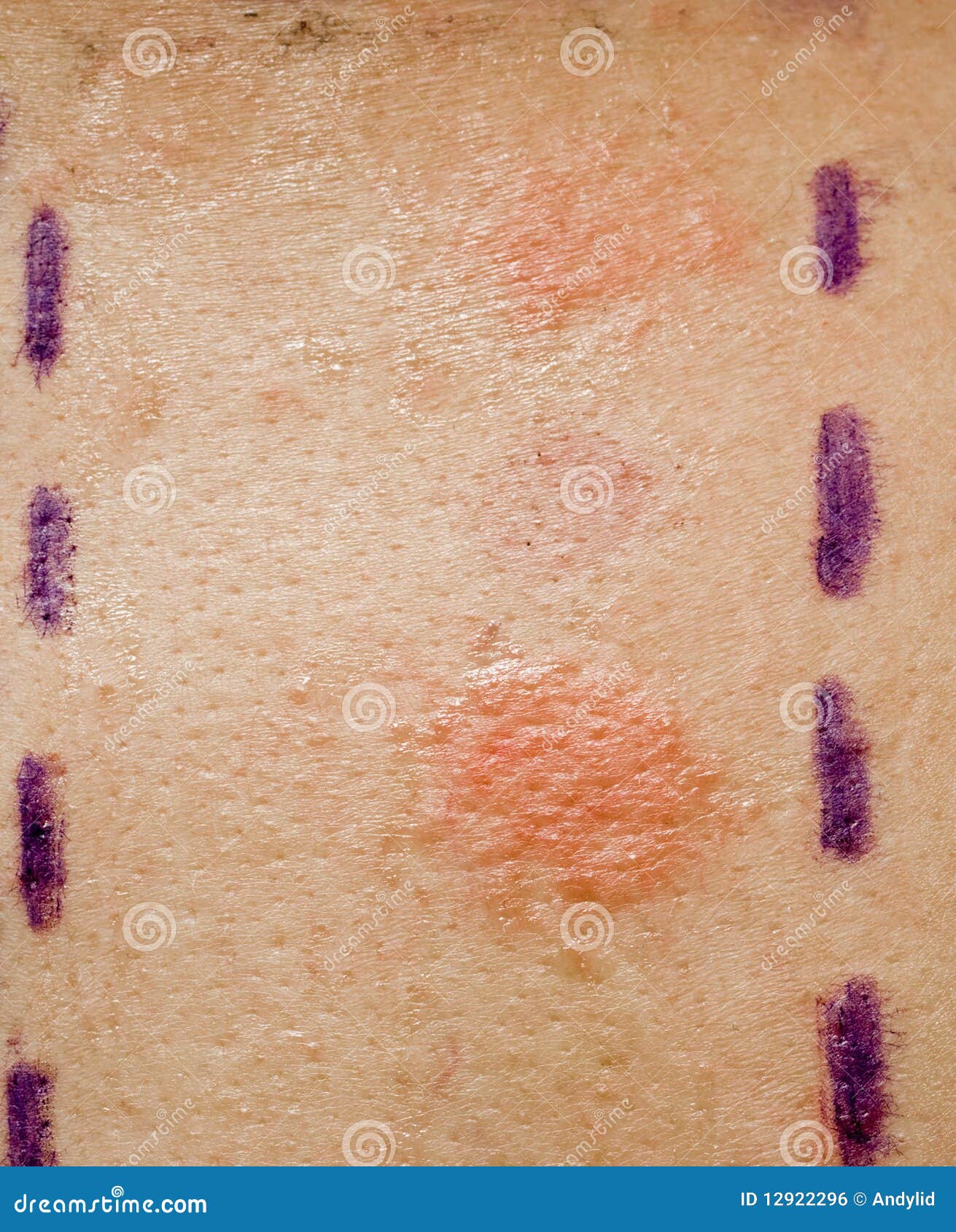 Skin Allergy Diseases Problem, Close Up Of Treatment On Atopic ...