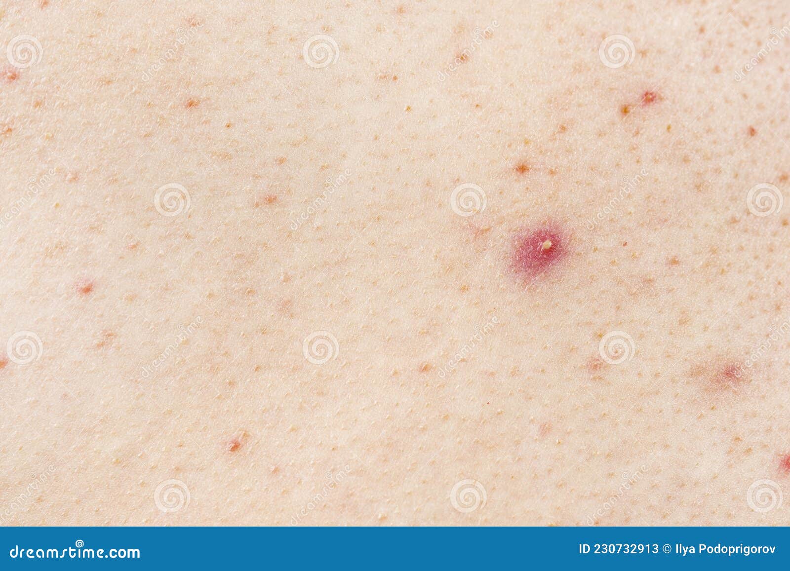 Skin Background Texture with Pimples and Blackheads. Problematic Skin ...